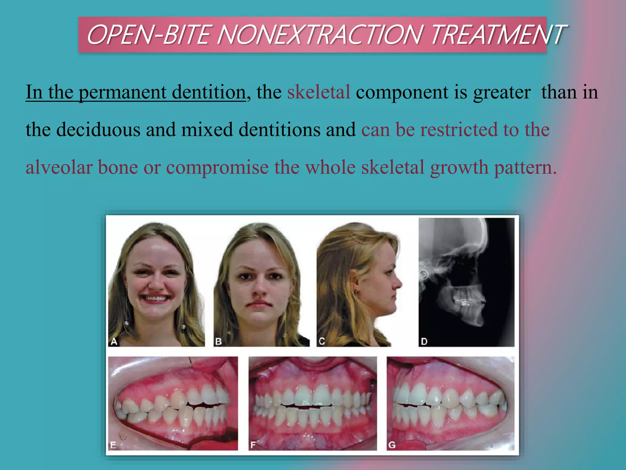 Elastics for open bite treatment | PPTX