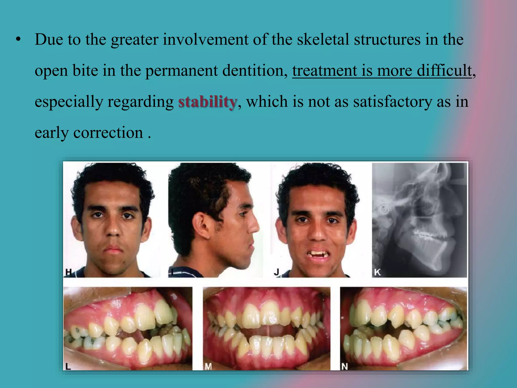 Elastics for open bite treatment | PPTX