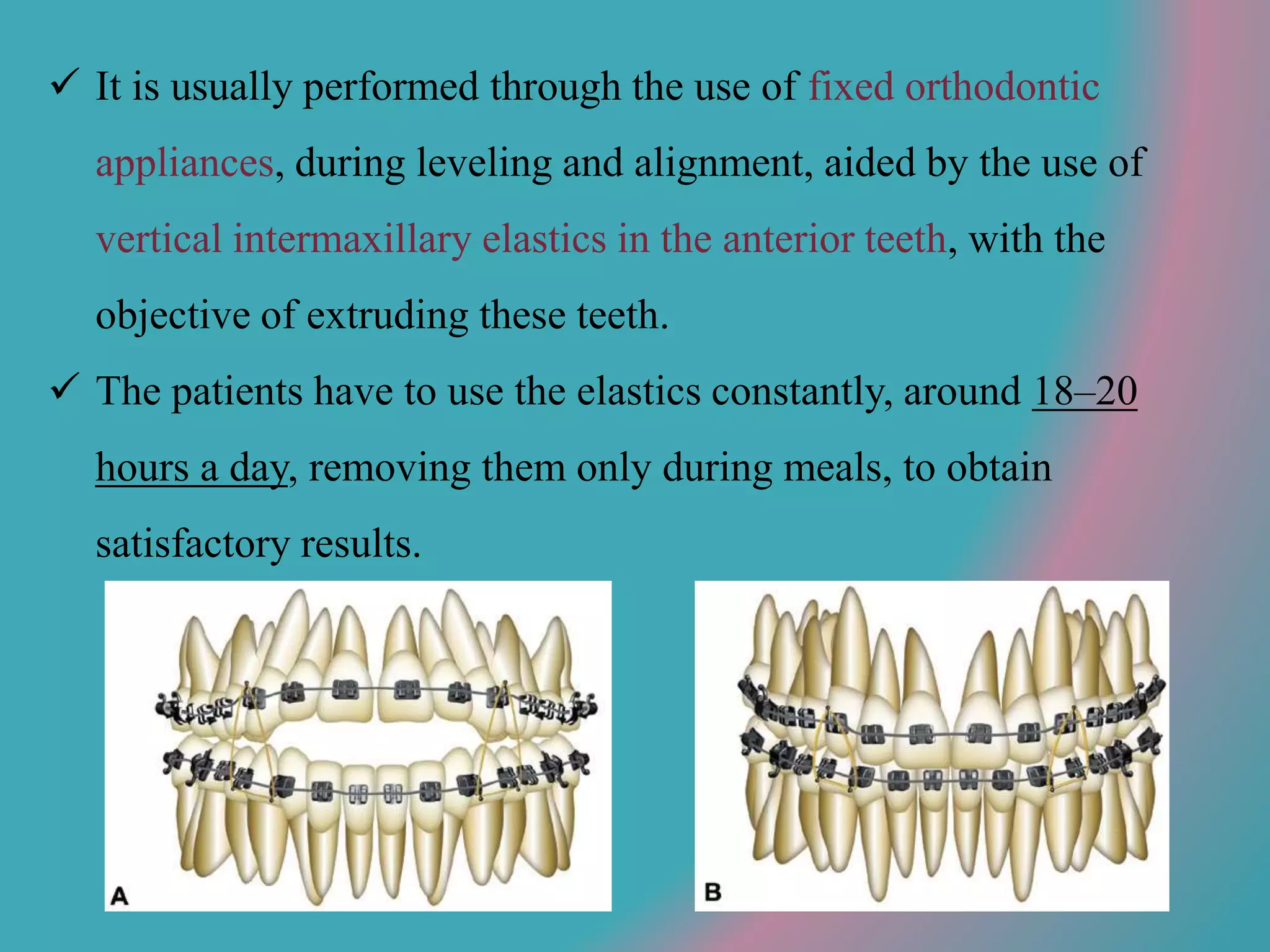 Elastics for open bite treatment | PPTX