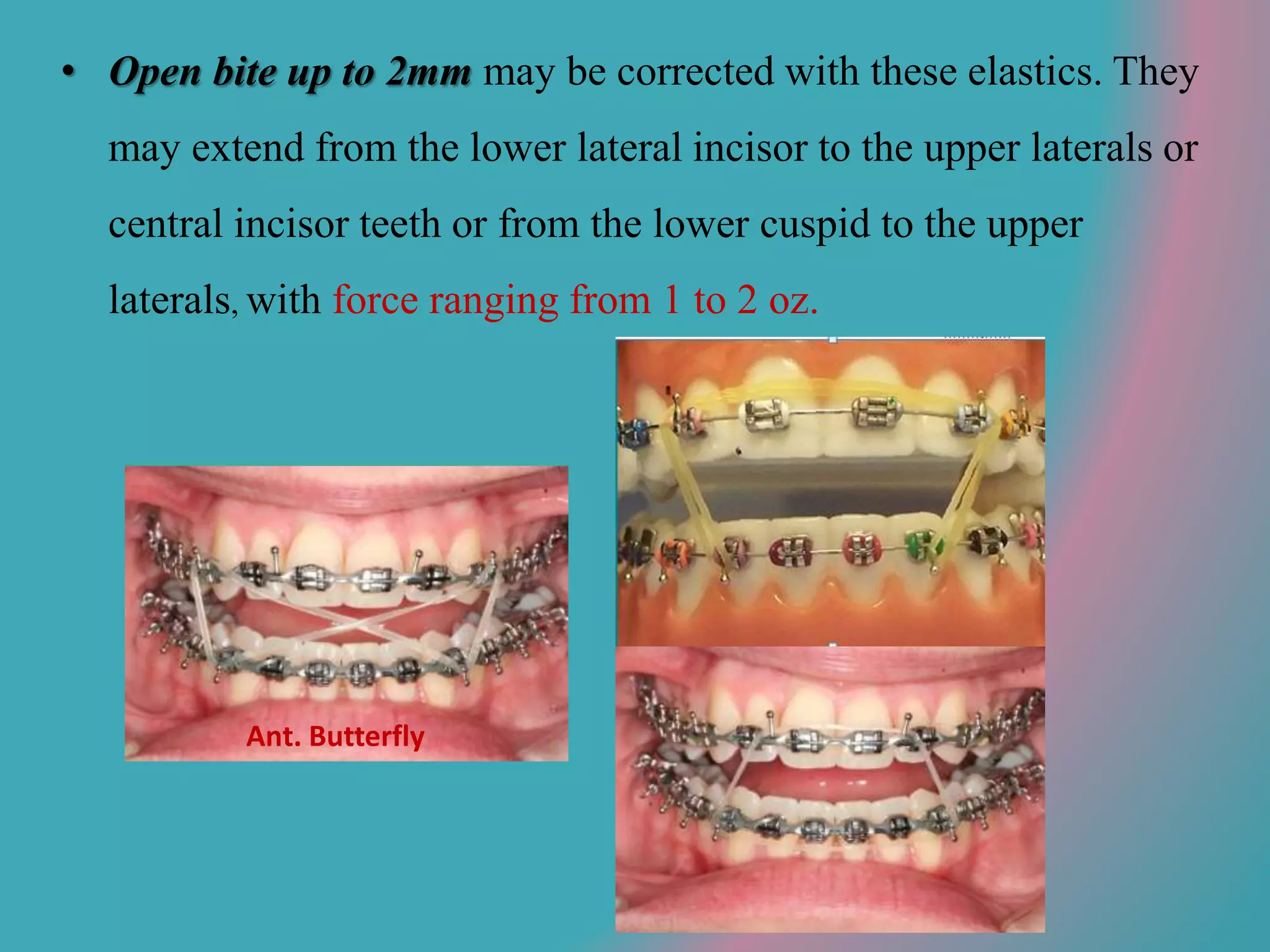 Elastics for open bite treatment | PPTX