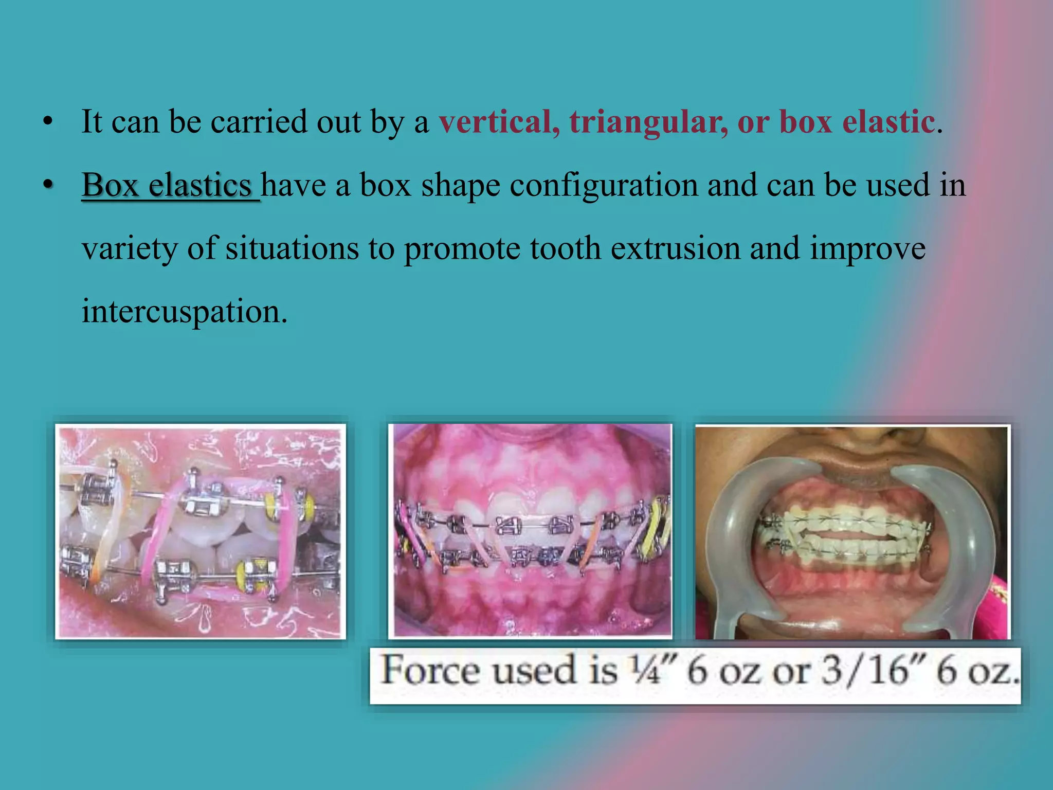 Elastics for open bite treatment | PPTX