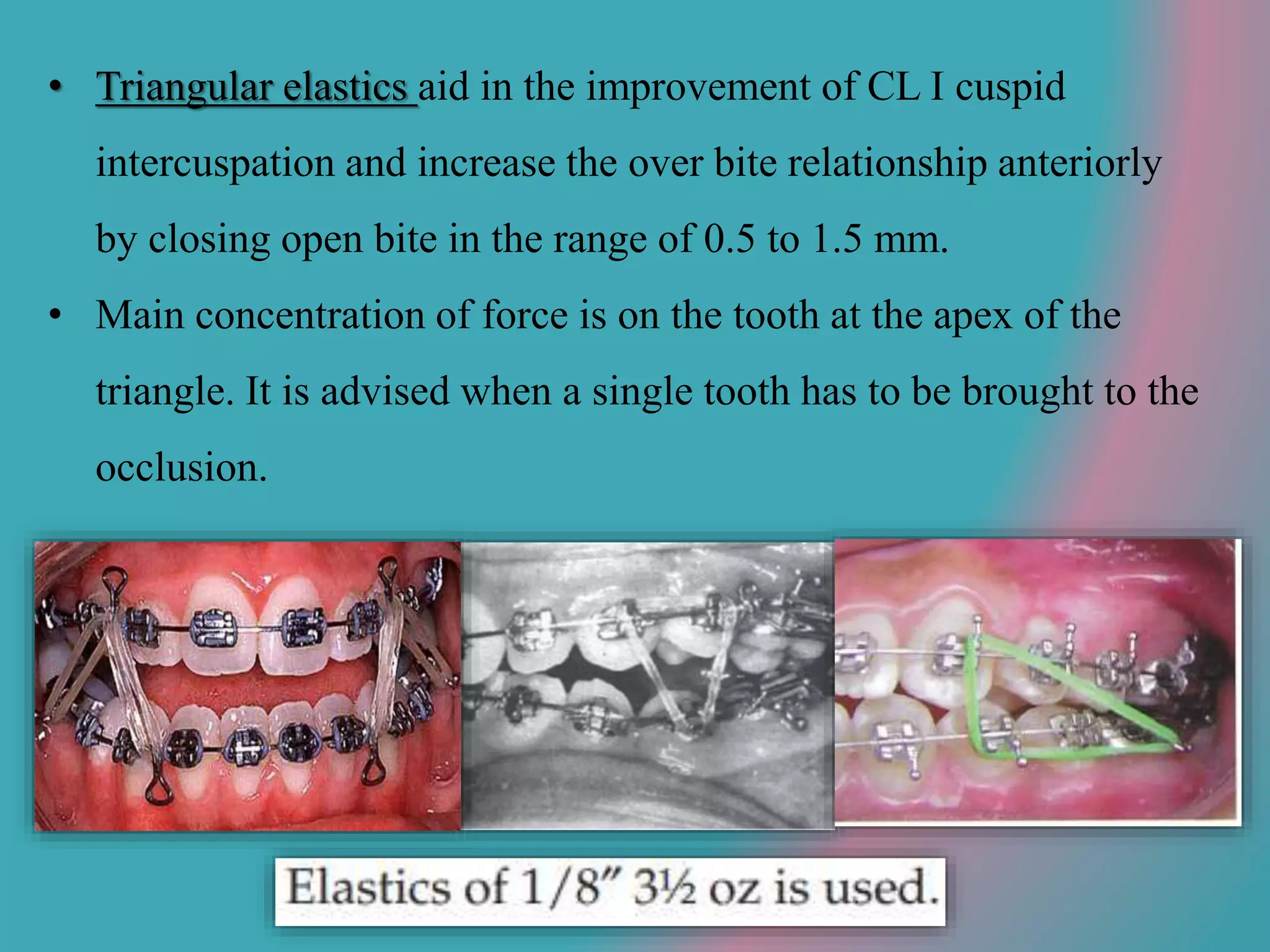 Elastics for open bite treatment | PPTX
