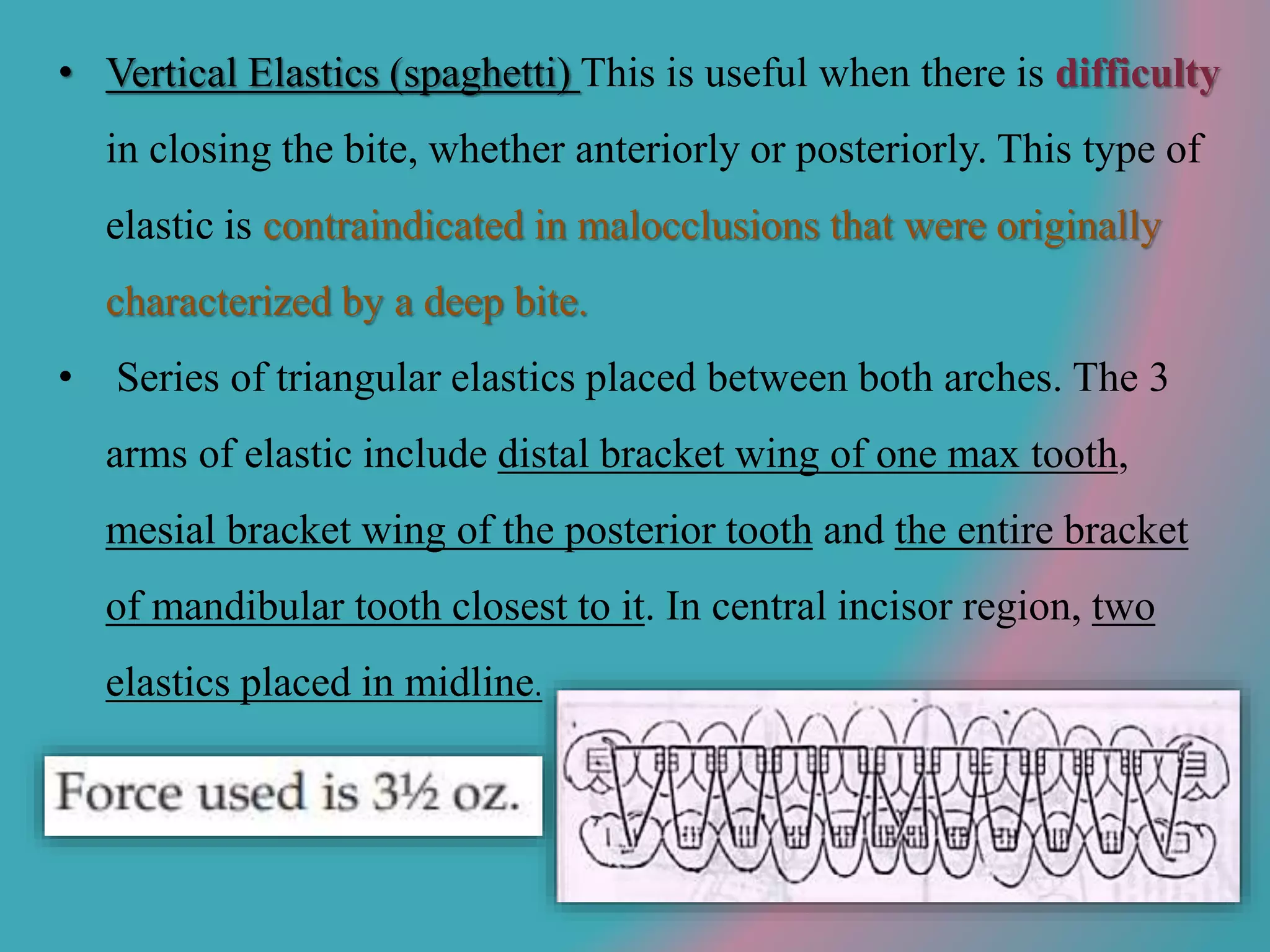 Elastics for open bite treatment | PPTX