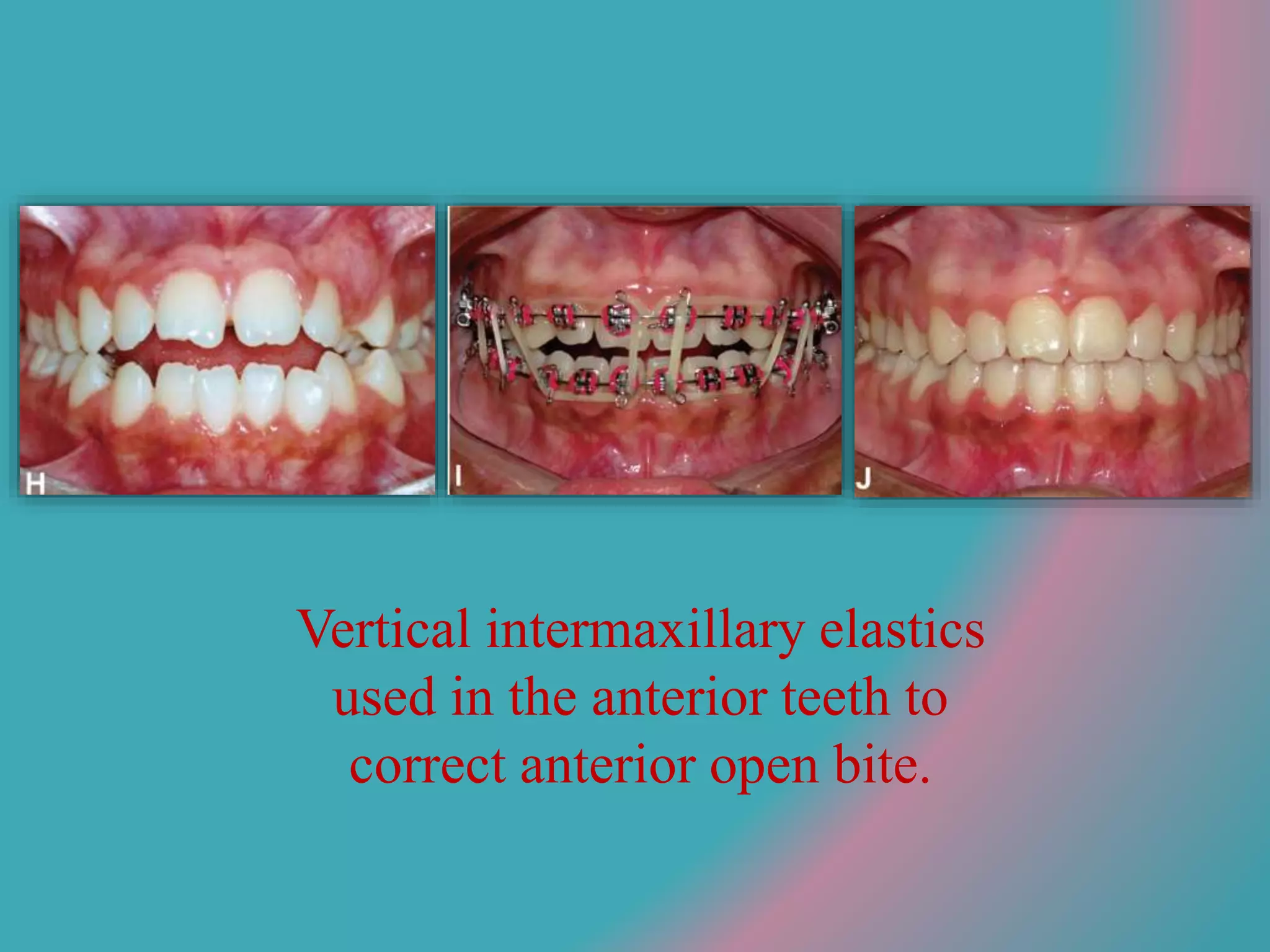 Elastics for open bite treatment | PPTX