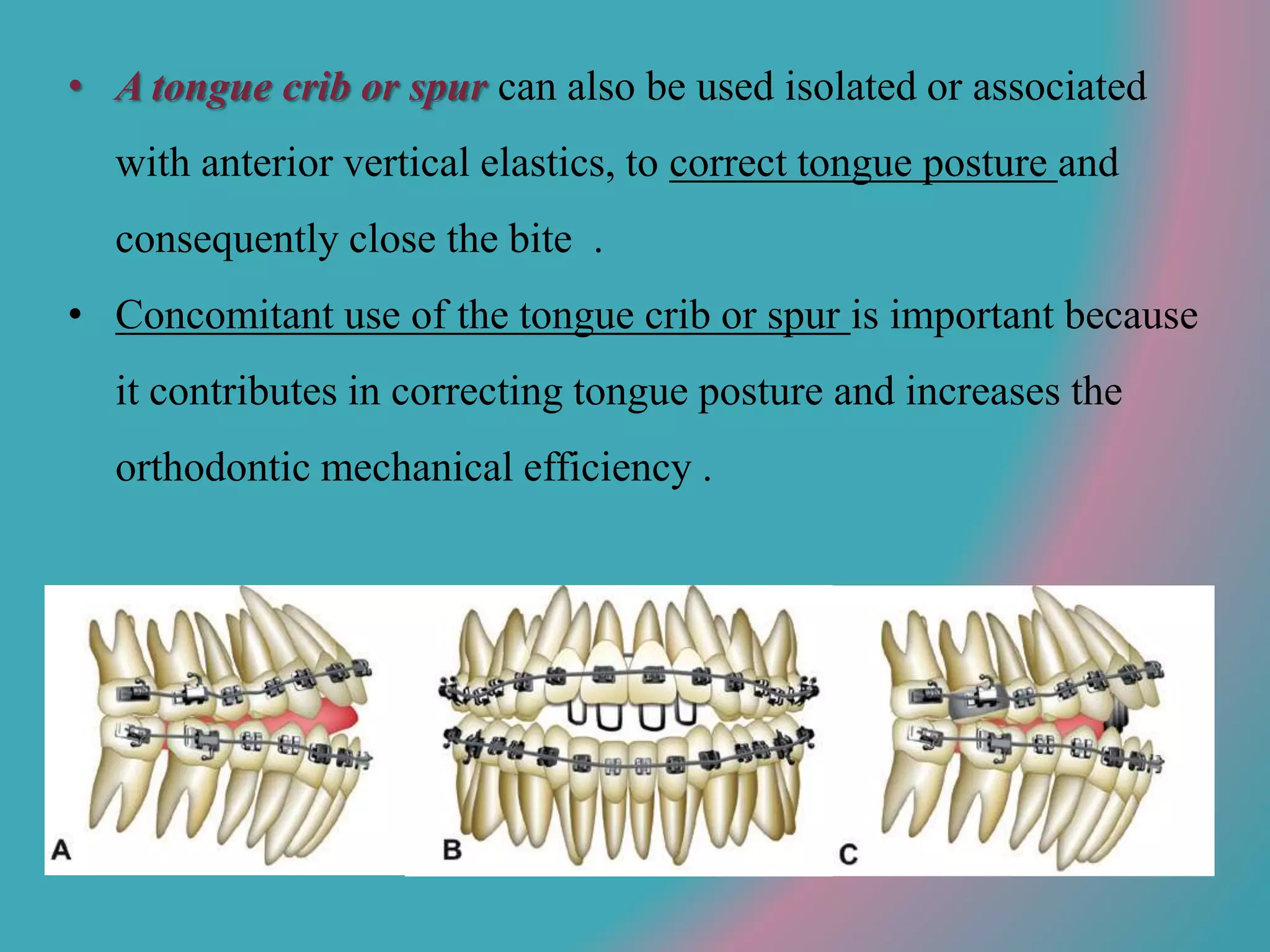Elastics for open bite treatment | PPTX