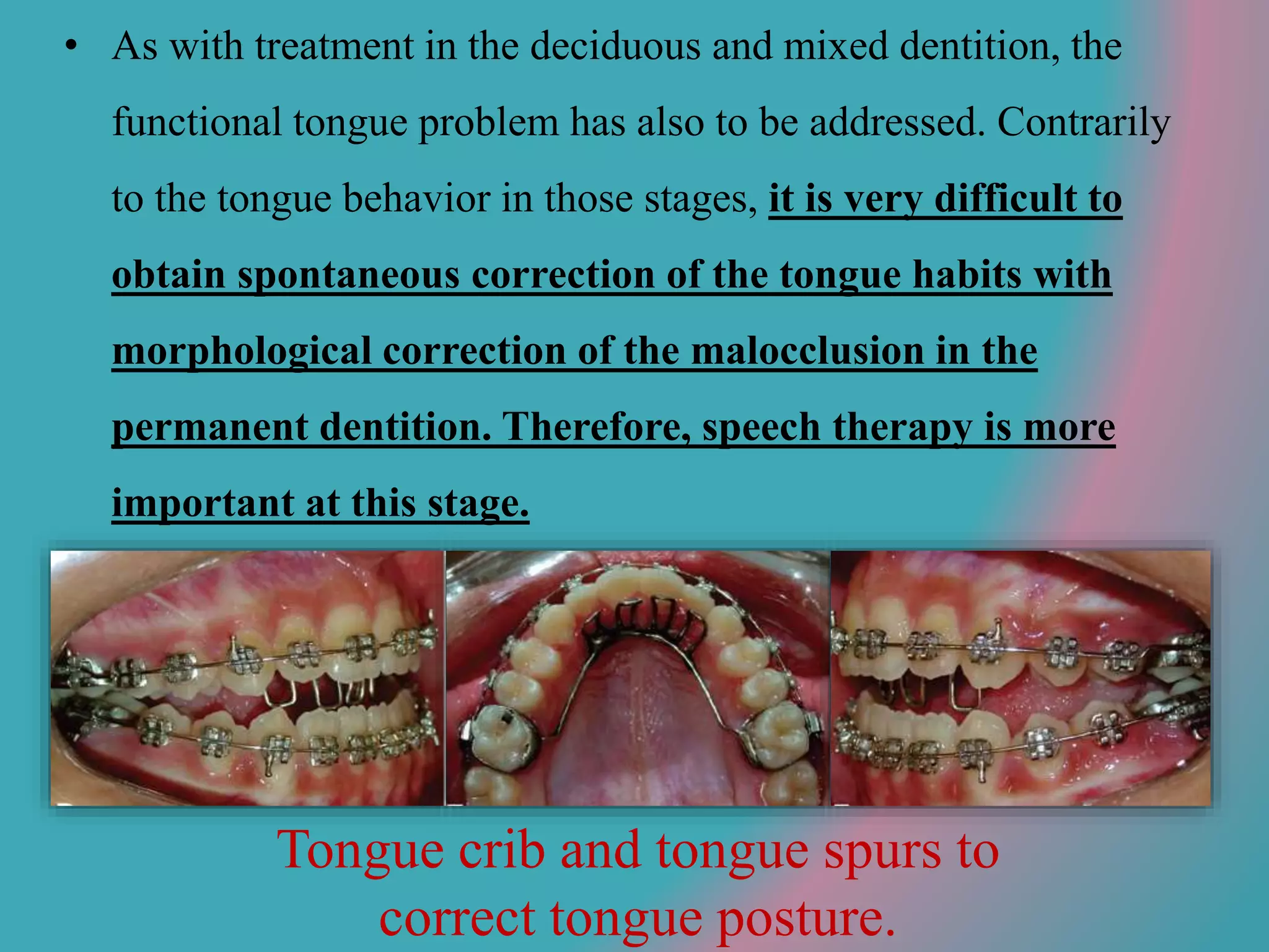 Elastics for open bite treatment | PPTX