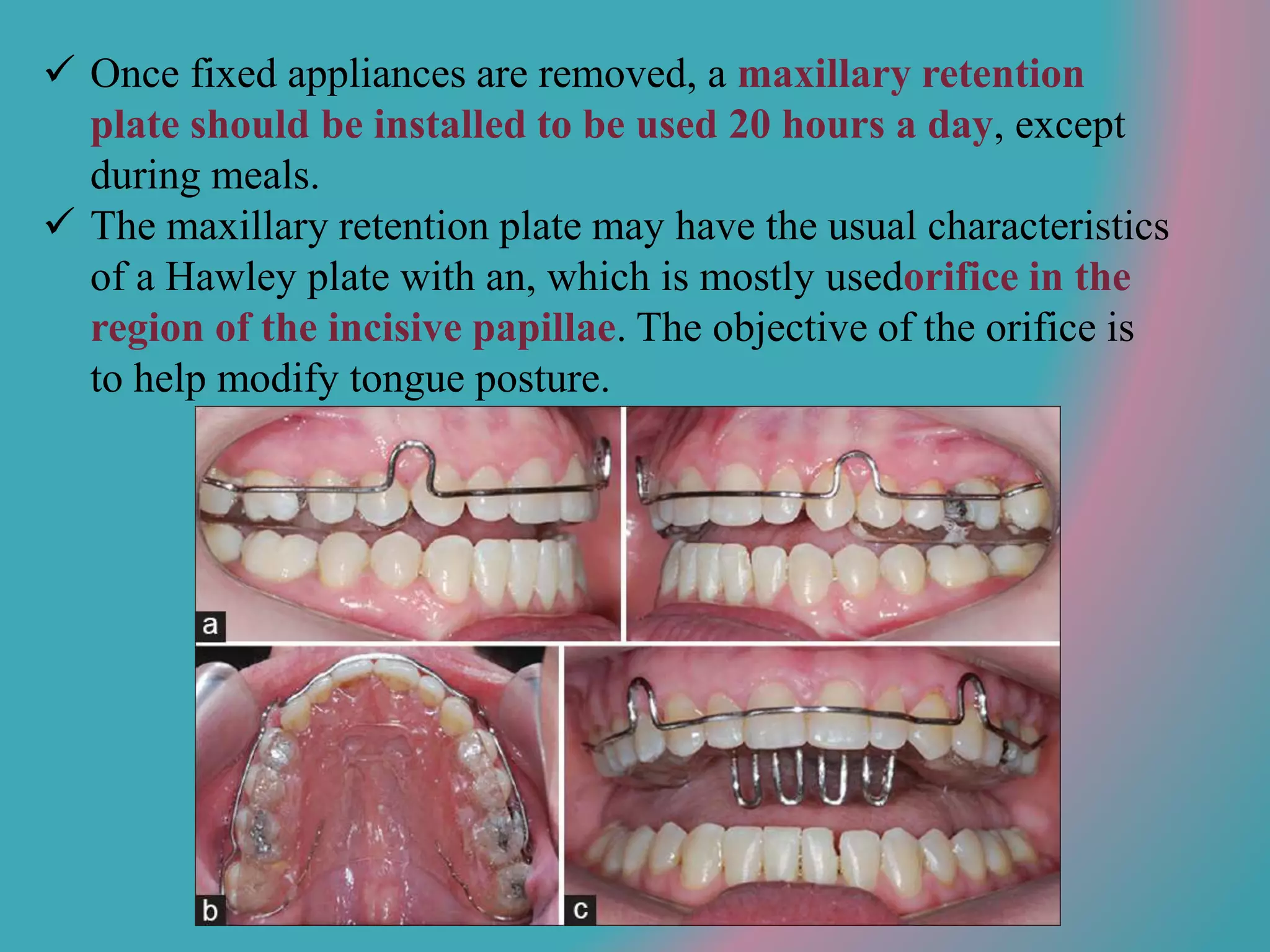 Elastics for open bite treatment | PPTX
