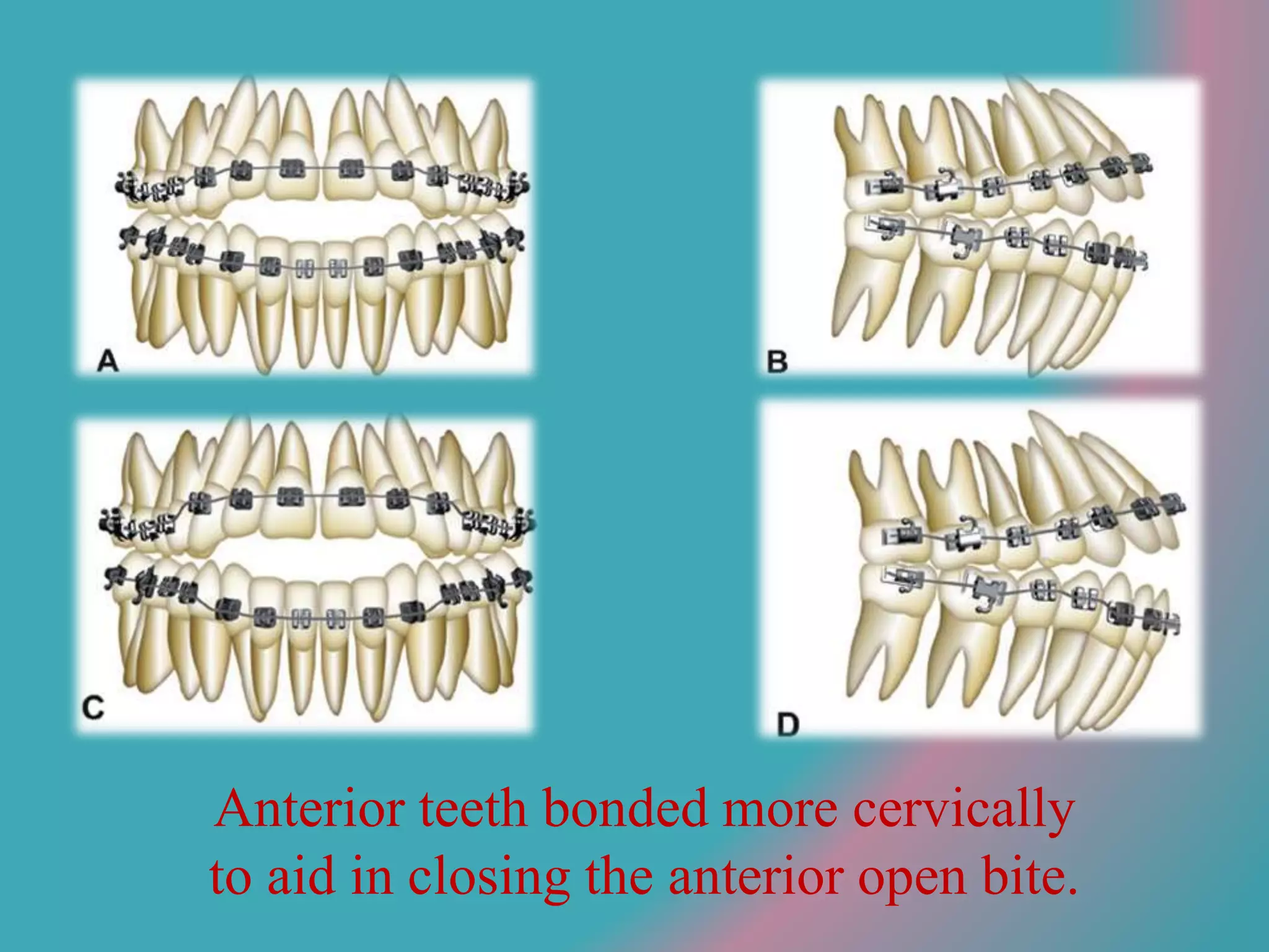 Elastics for open bite treatment | PPTX