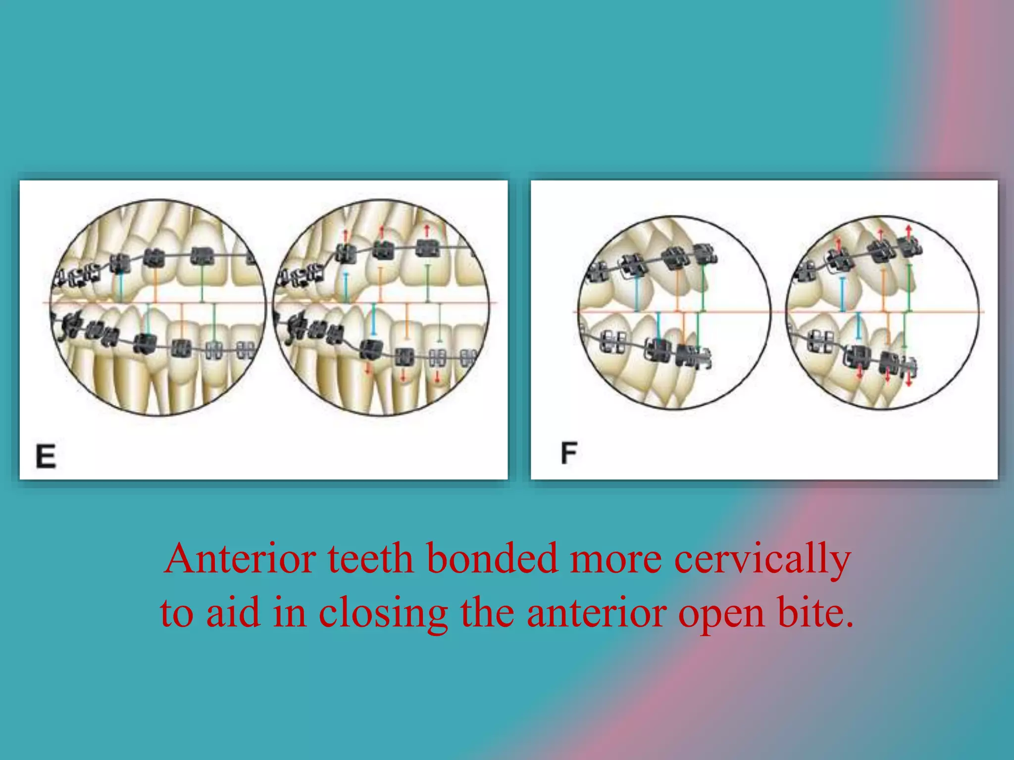 Elastics for open bite treatment | PPTX