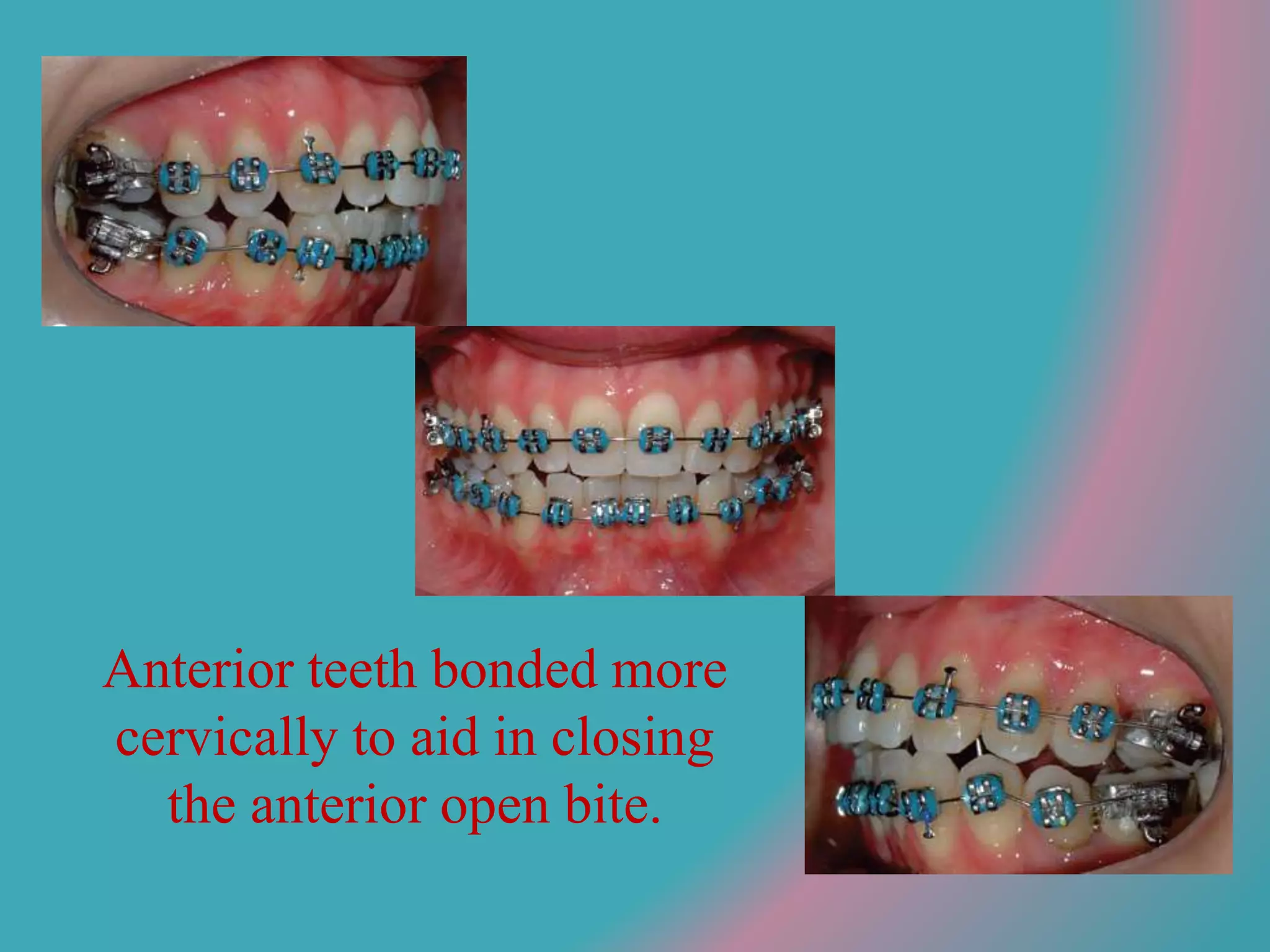 Elastics for open bite treatment | PPTX