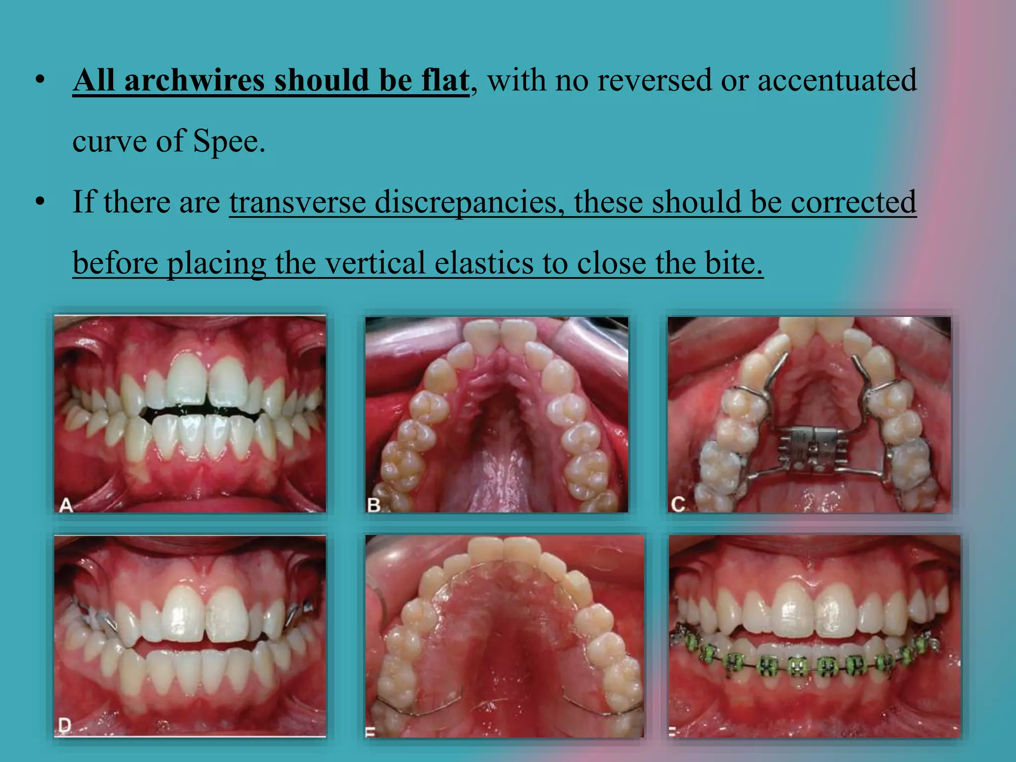 Elastics for open bite treatment | PPTX