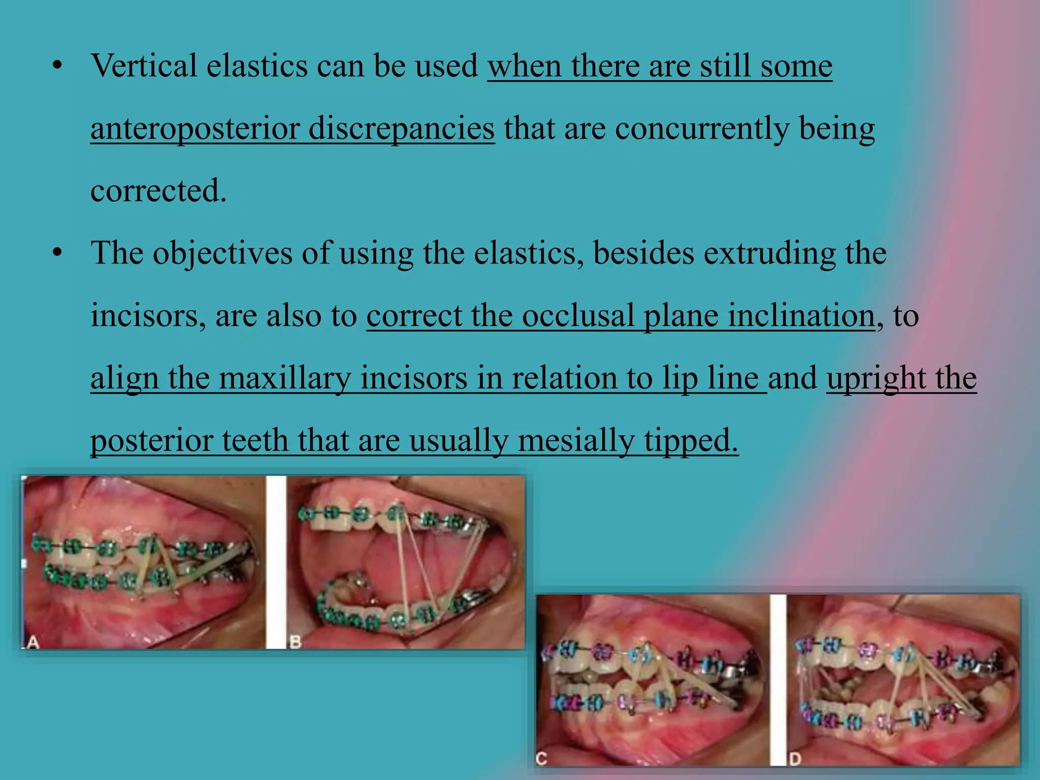 Elastics for open bite treatment | PPTX
