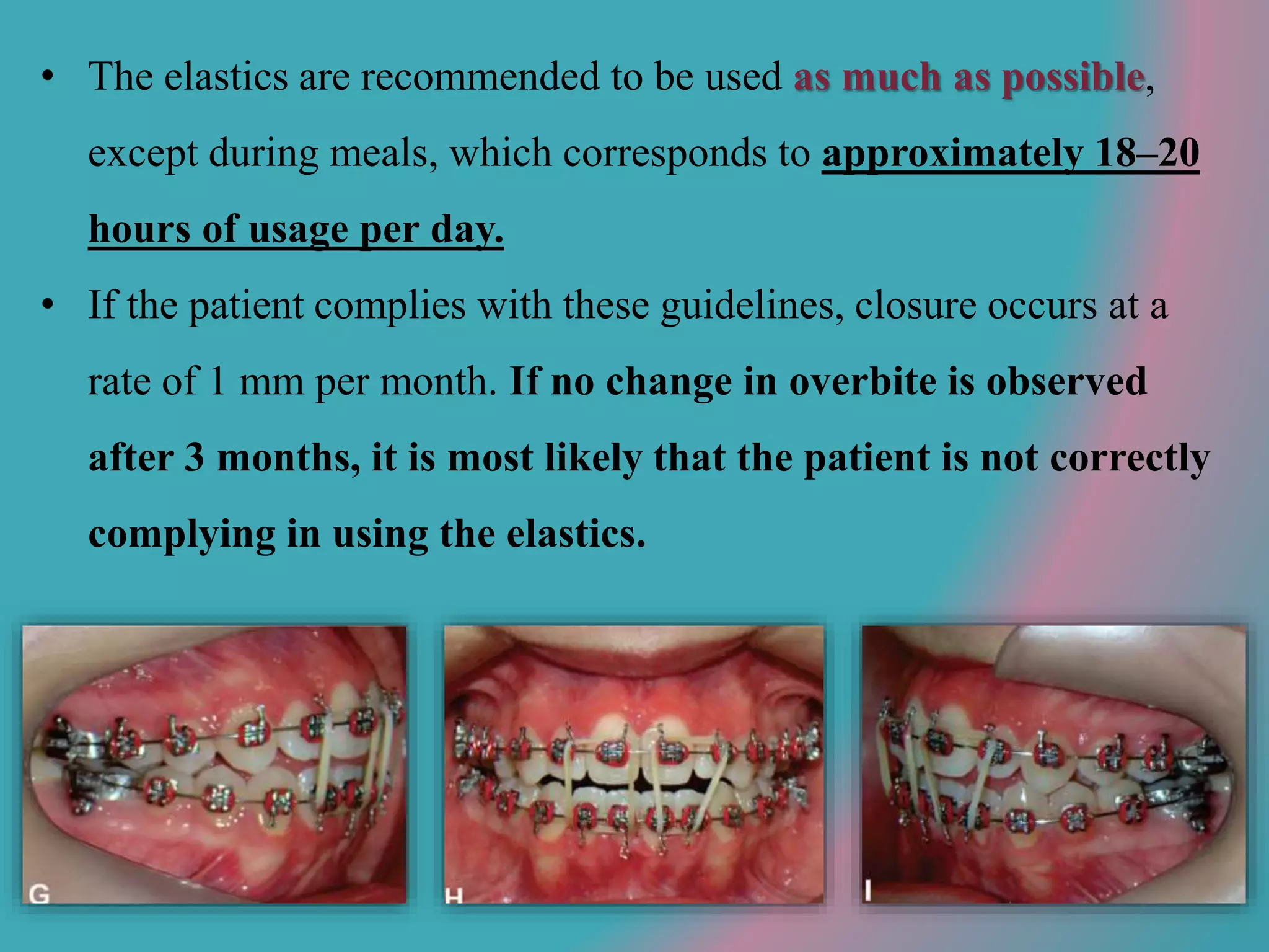 Elastics for open bite treatment | PPTX