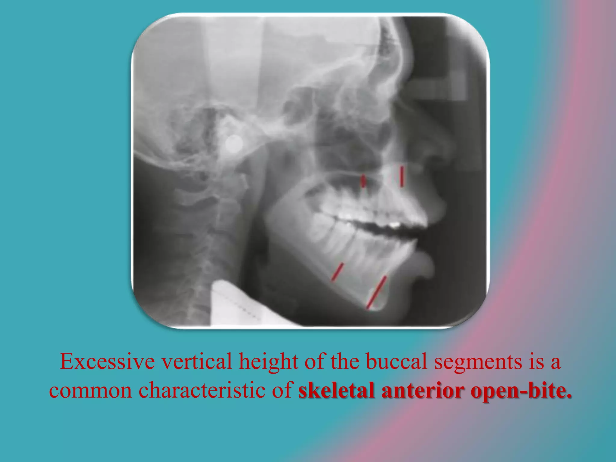 Elastics for open bite treatment | PPTX