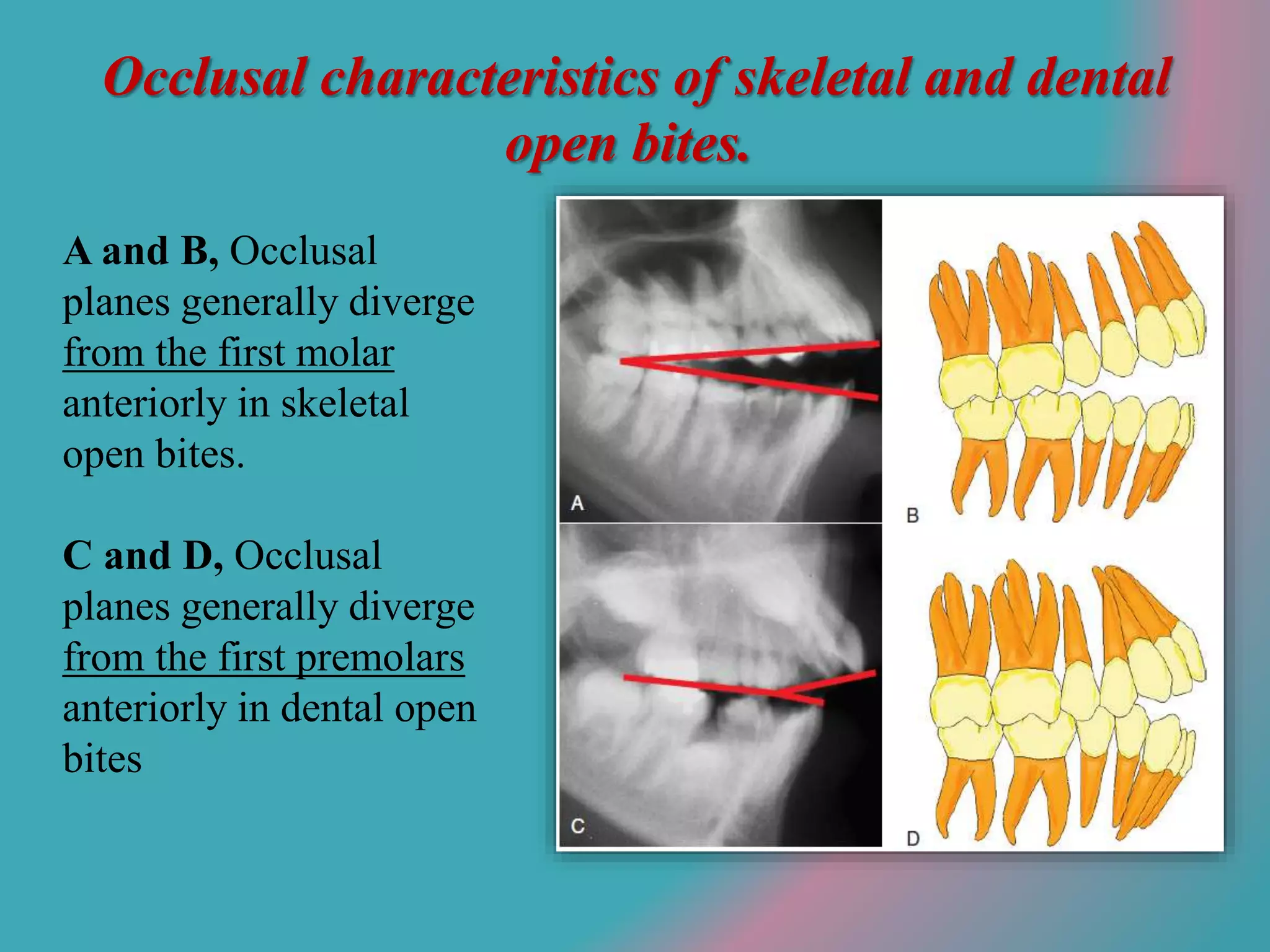 Elastics for open bite treatment | PPTX