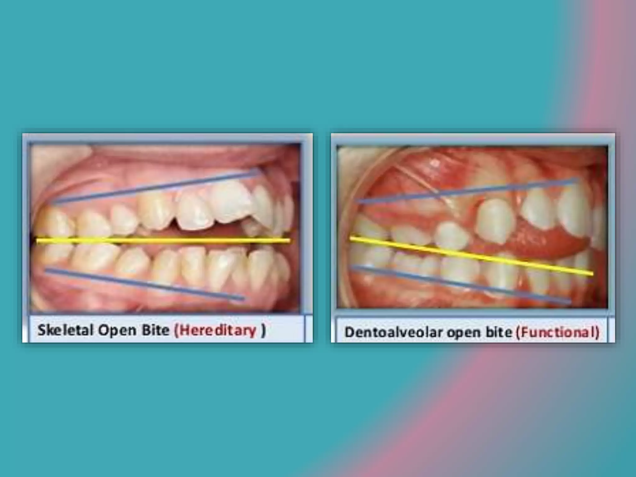 Elastics for open bite treatment | PPTX