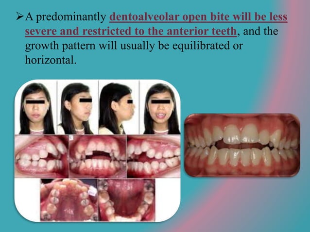 Elastics for open bite treatment | PPTX
