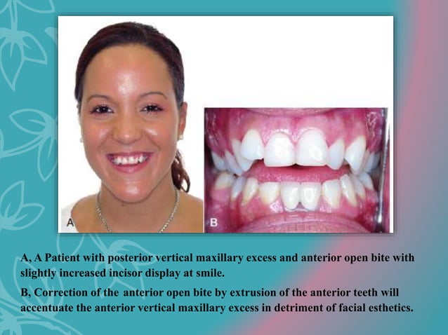 Elastics for open bite treatment | PPTX