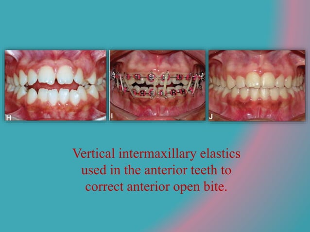 Elastics for open bite treatment | PPTX