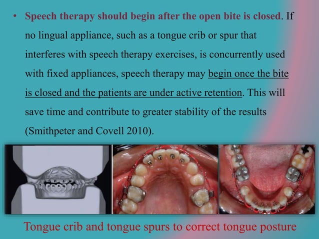 Elastics for open bite treatment | PPTX