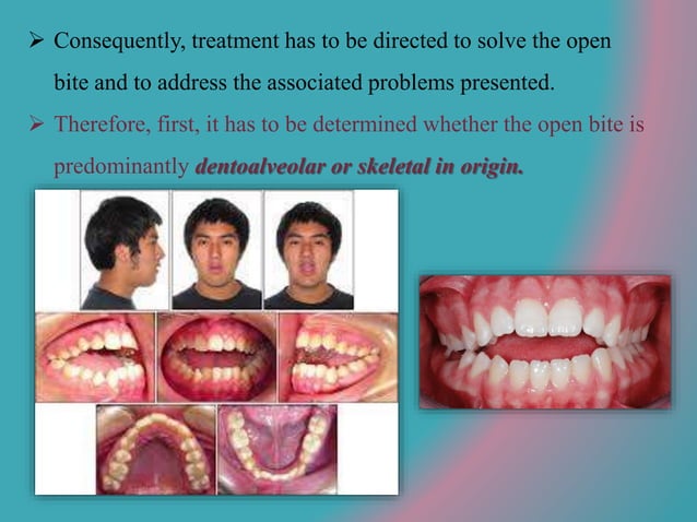 Elastics for open bite treatment | PPTX