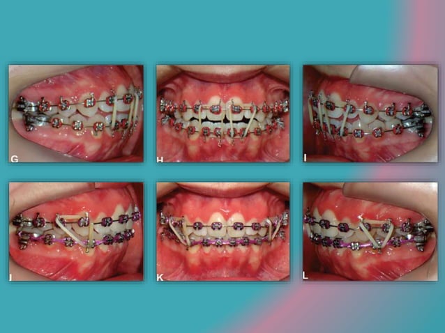 Elastics for open bite treatment | PPTX