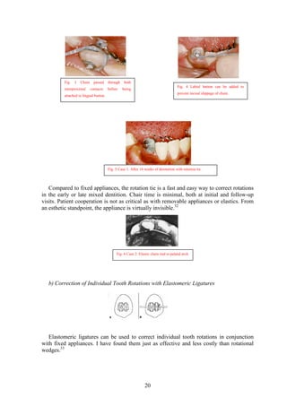 Elastics in orthodontics | PDF
