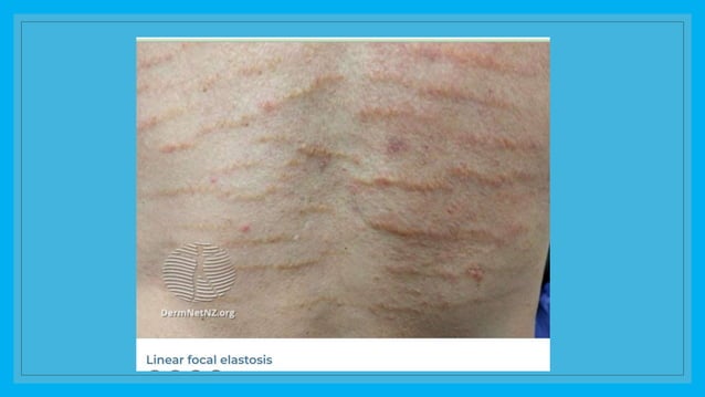 Acquired elastic tissue disorders part one | PPTX | Skin and ...