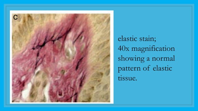 Acquired elastic tissue disorders part one | PPTX | Skin and ...