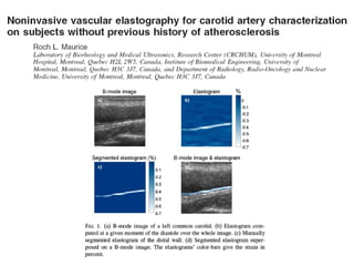 Carotid elastography | PPT