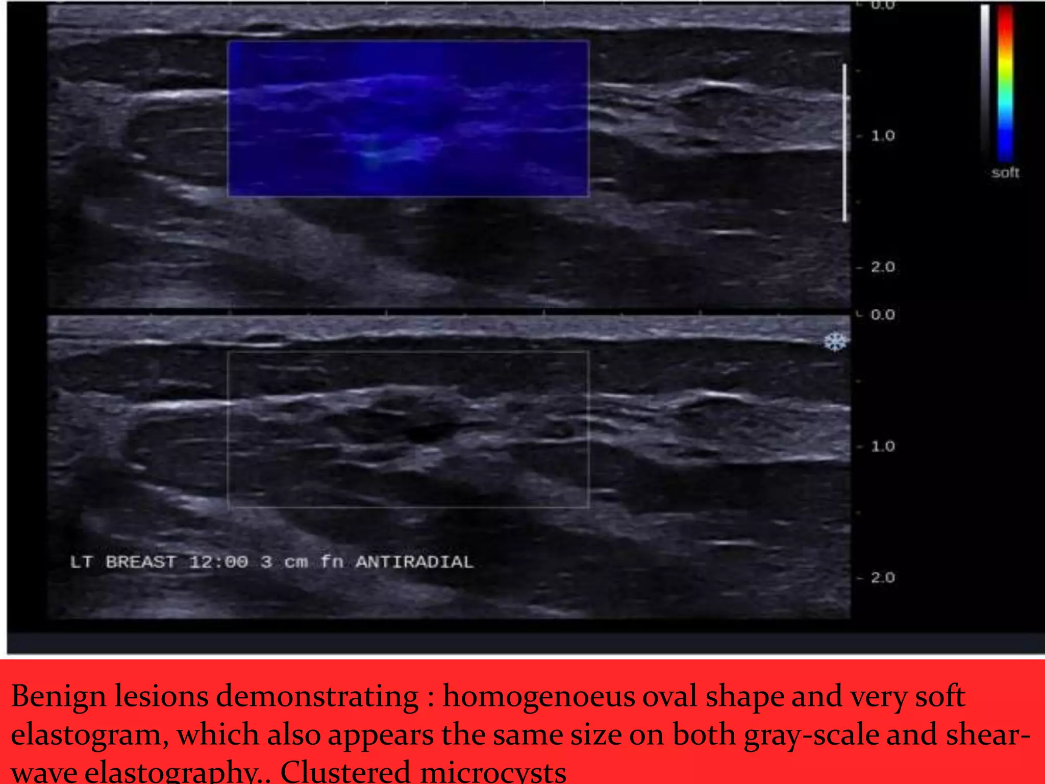 Elastography | PPTX