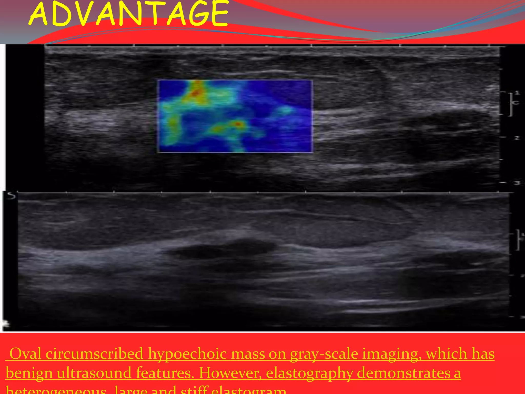 Elastography | PPTX