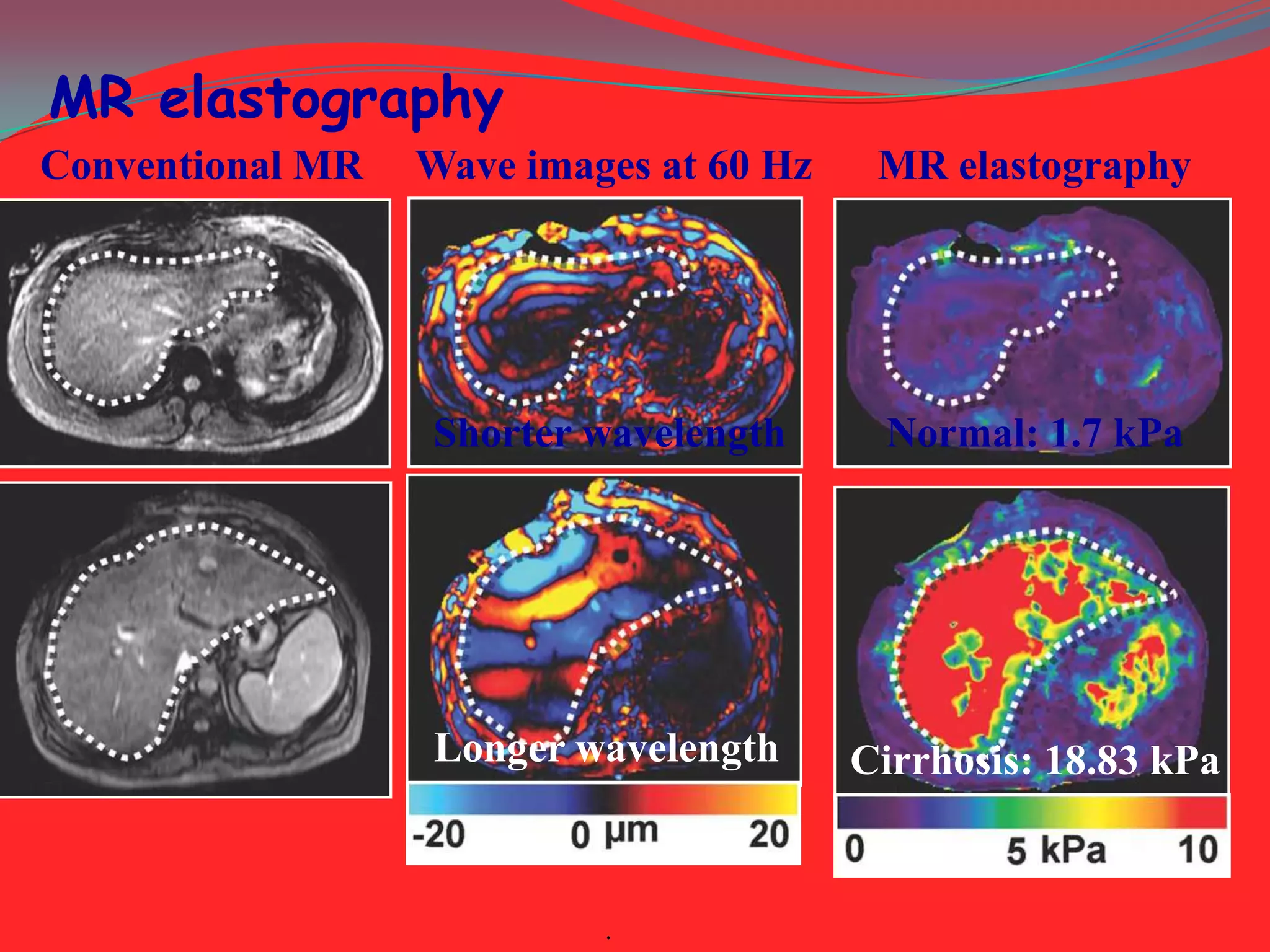 Elastography | PPTX