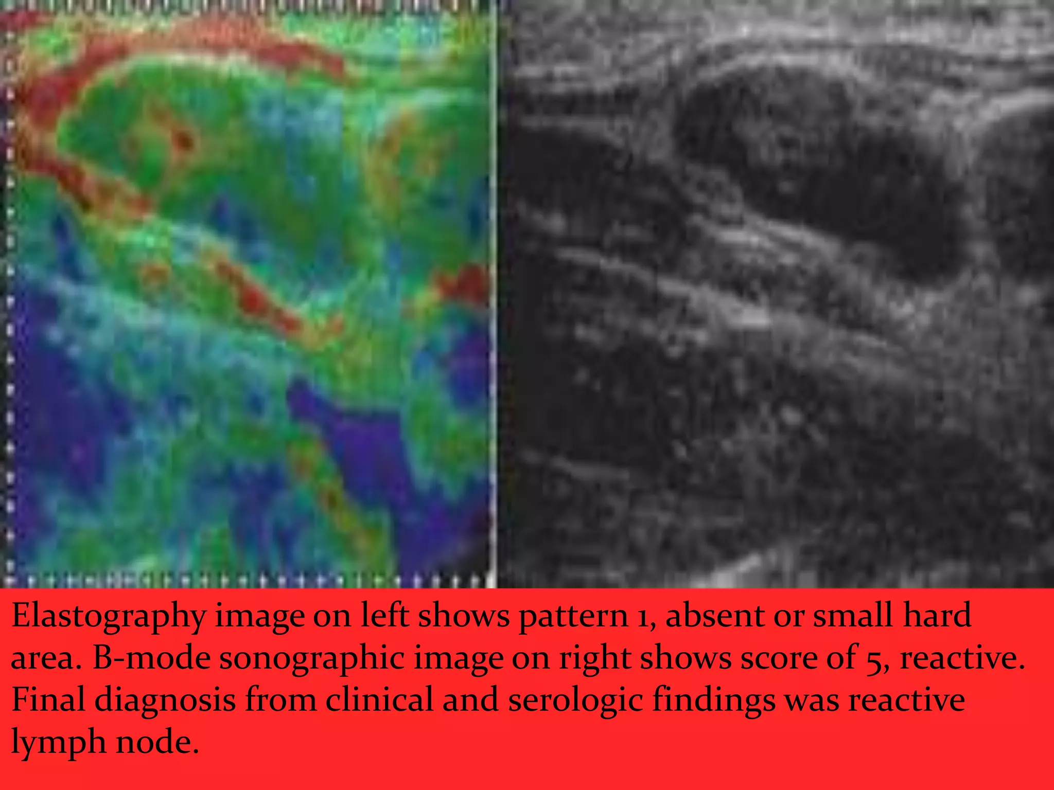Elastography | PPTX