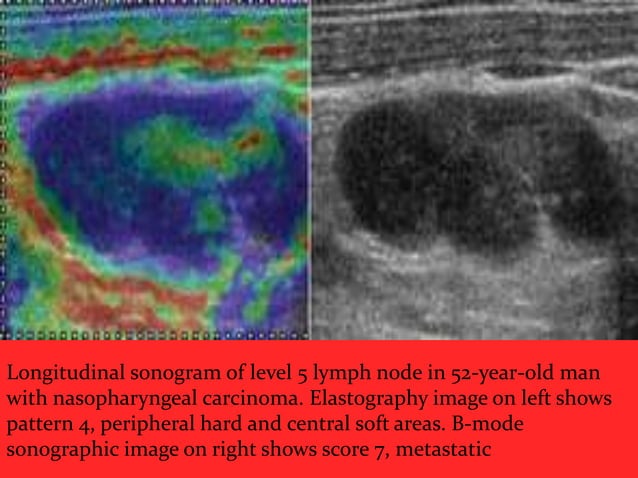 Elastography | PPT