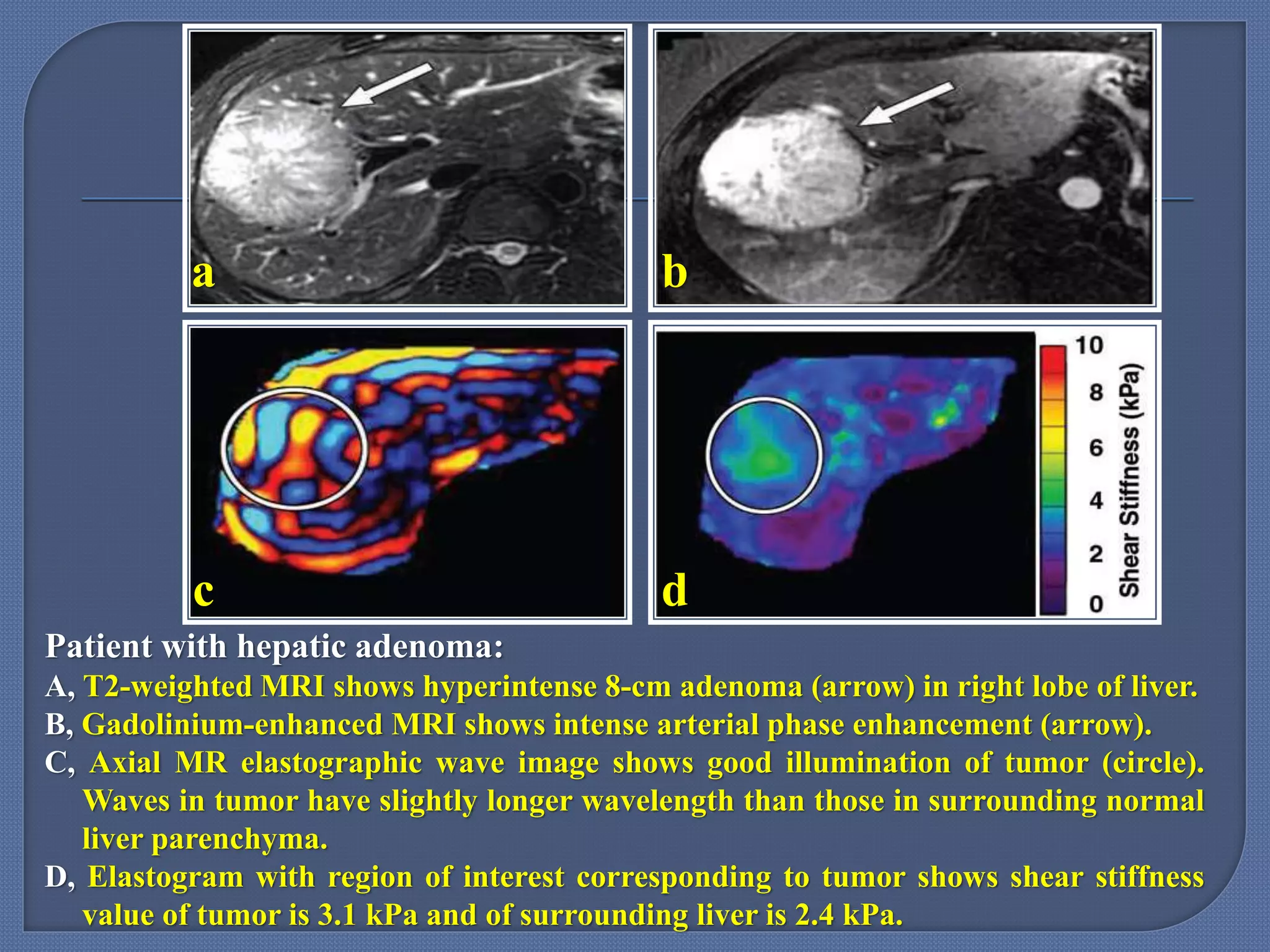 MR Elastography | PPTX