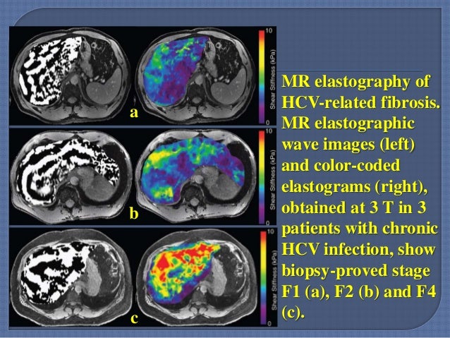 MR Elastography
