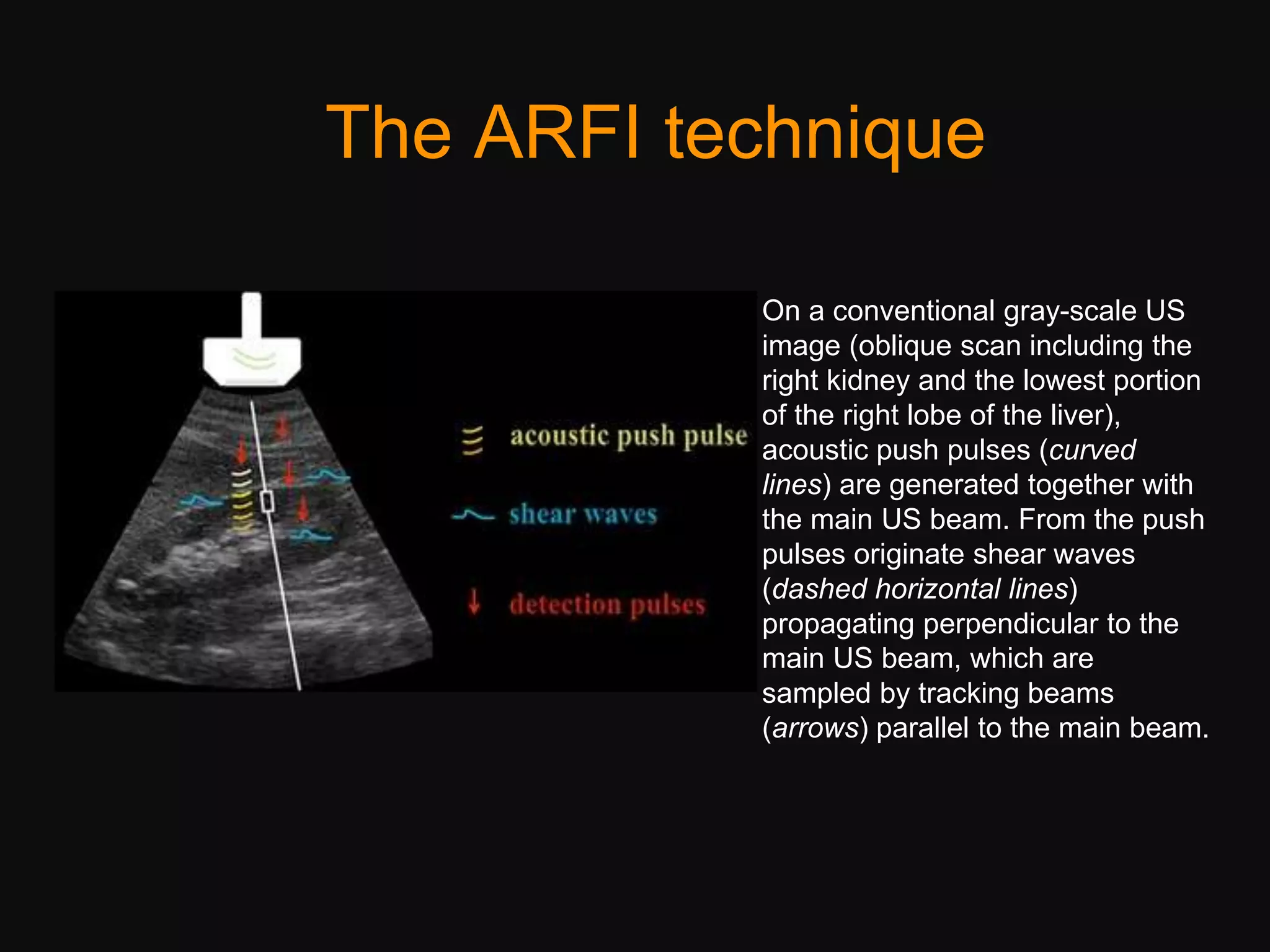 Shear wave Elastography of Liver | PPTX
