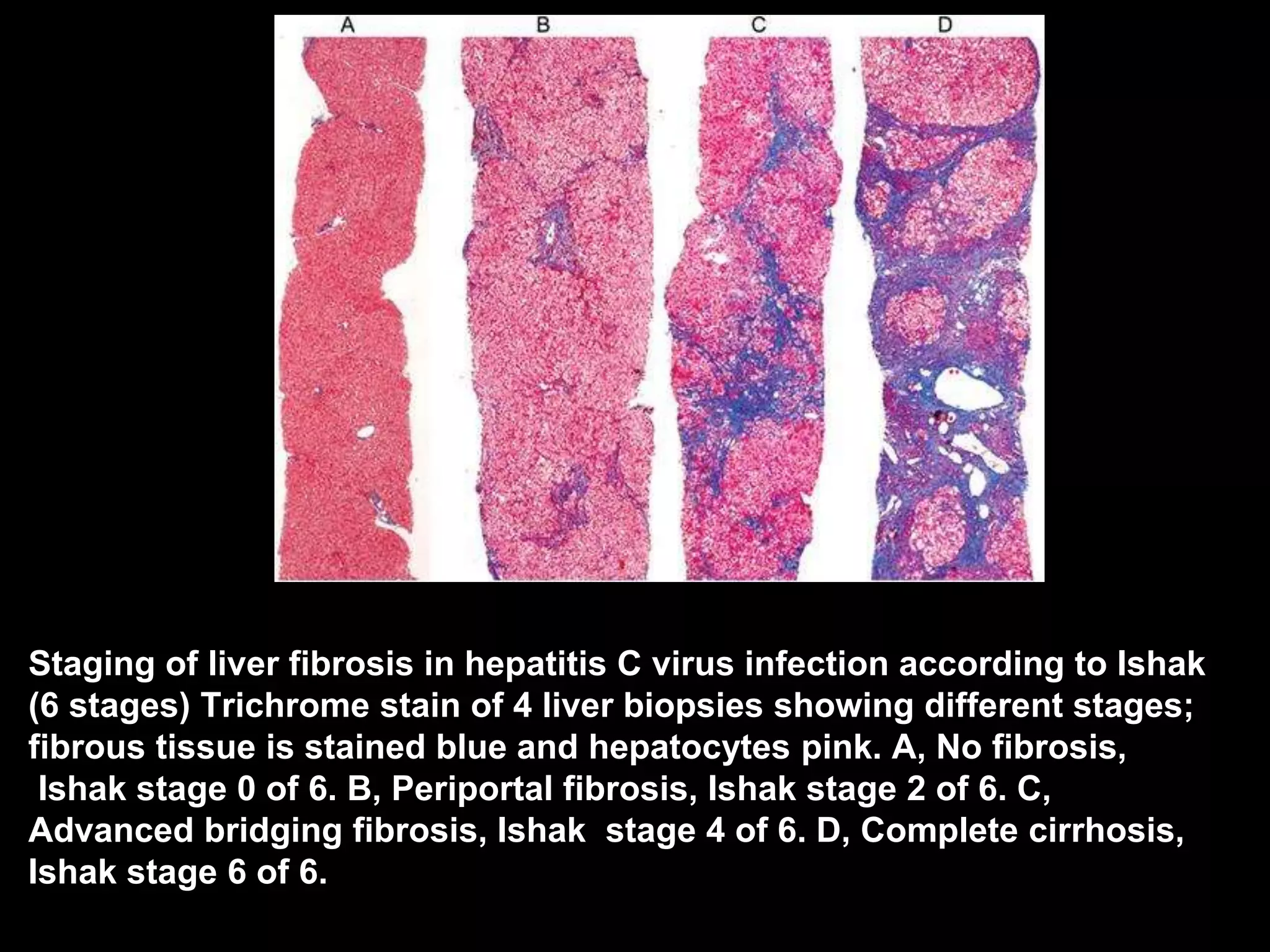 Shear wave Elastography of Liver | PPTX
