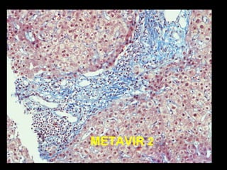 Shear wave Elastography of Liver | PPTX