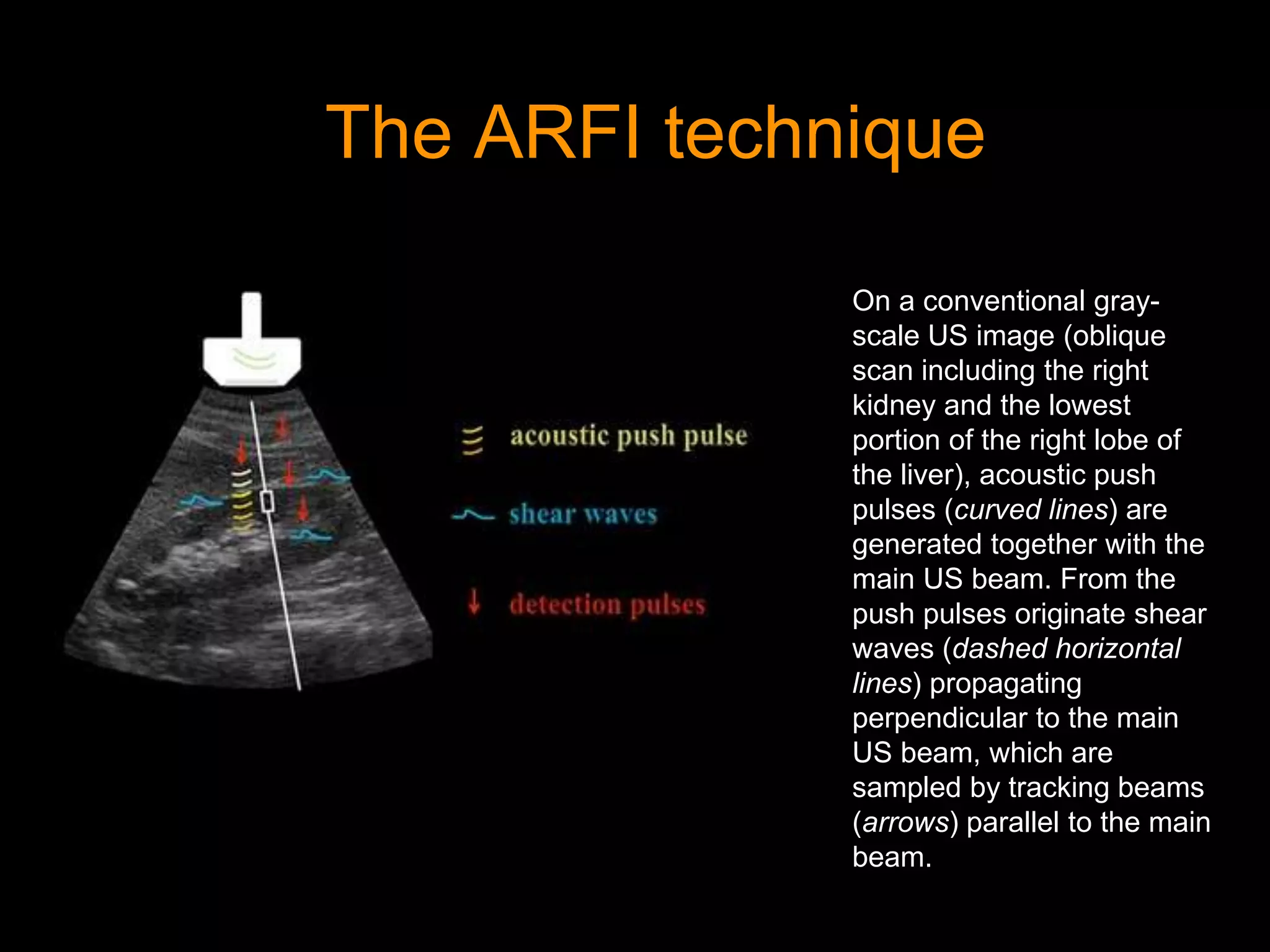 Liver Fibrosis - SWE and MRE | PPTX | Blood Disorders | Diseases and ...