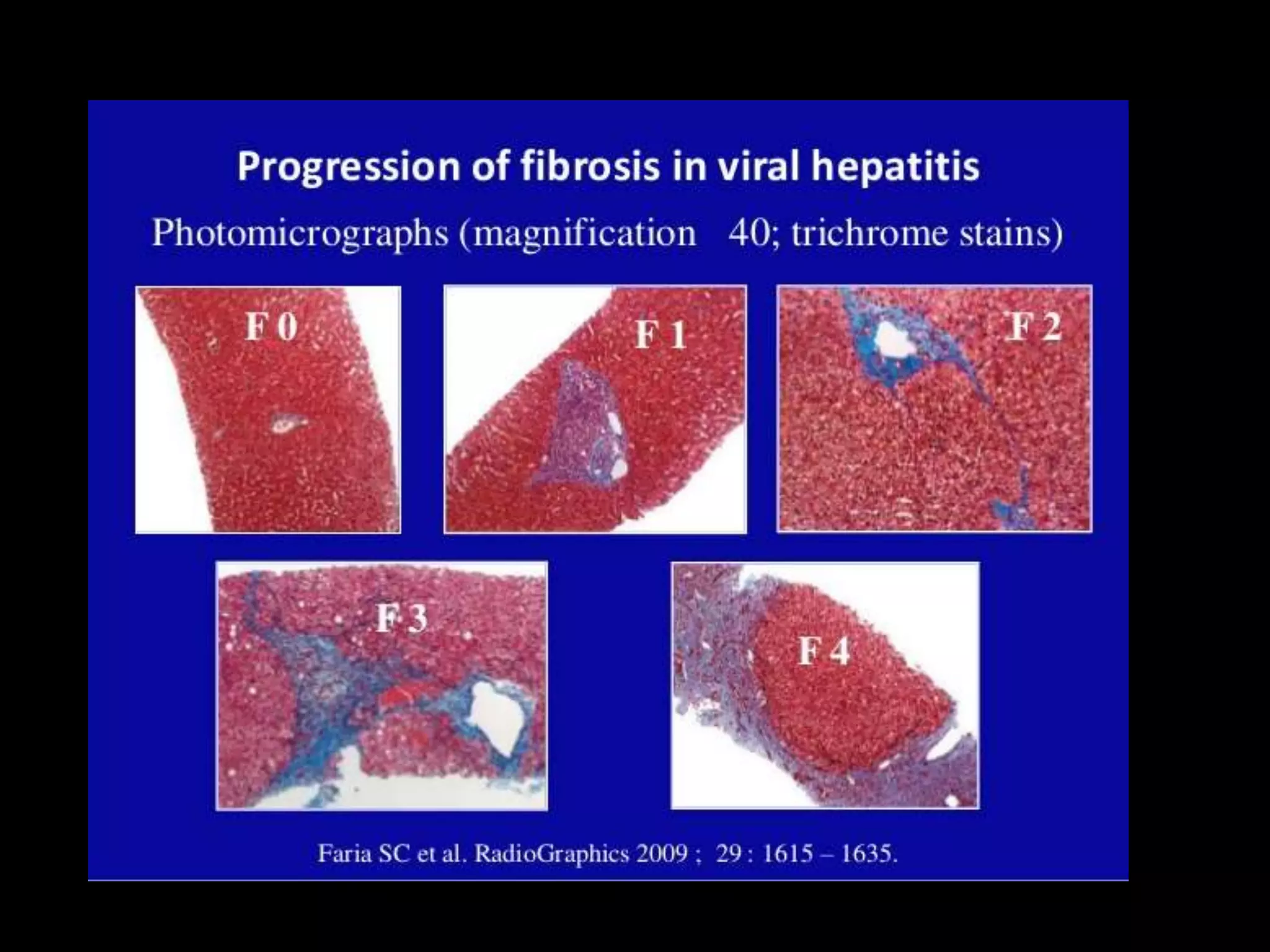 Liver Fibrosis - SWE and MRE | PPTX | Blood Disorders | Diseases and ...