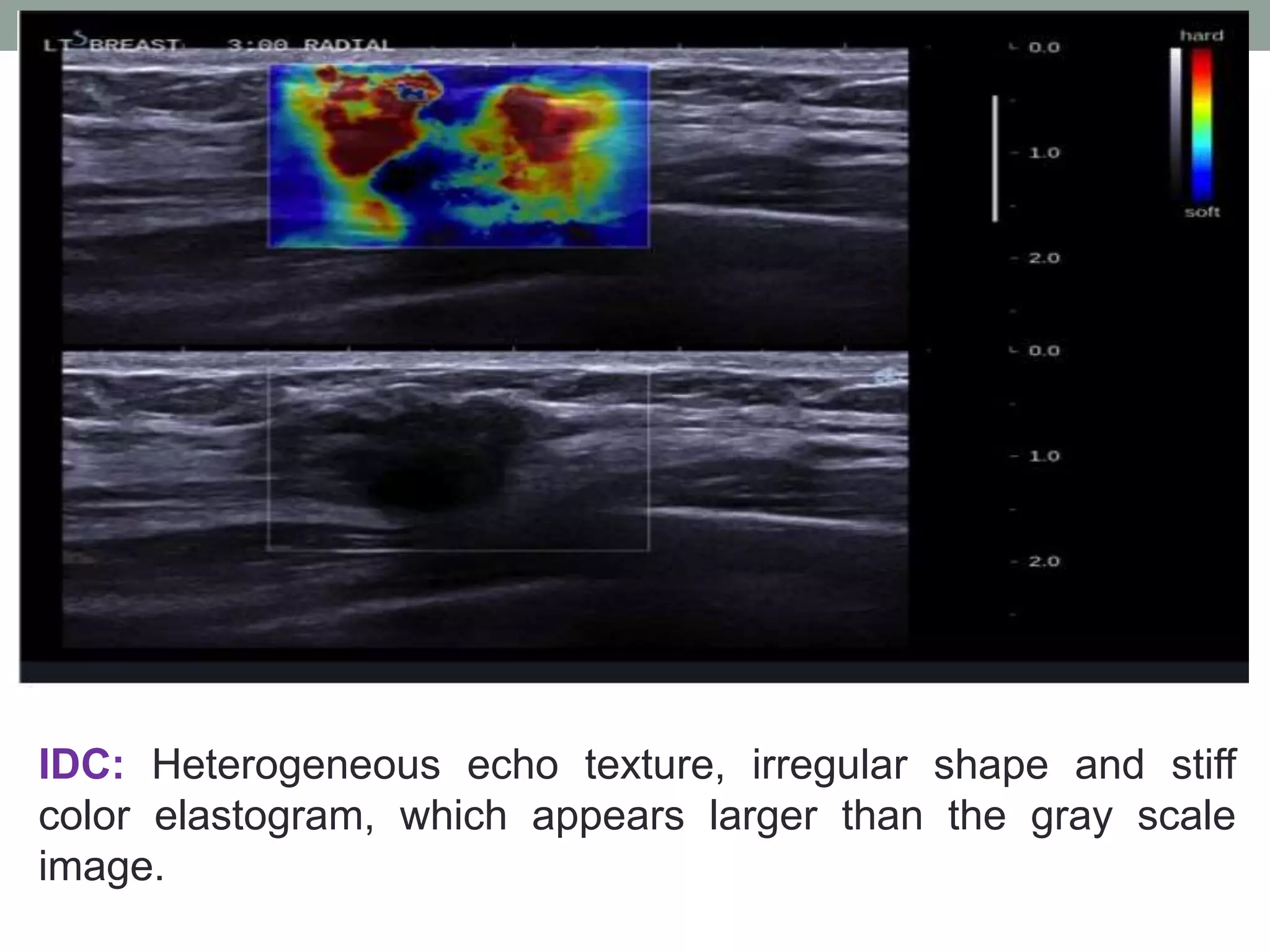 Elastography dr vineet | PPT