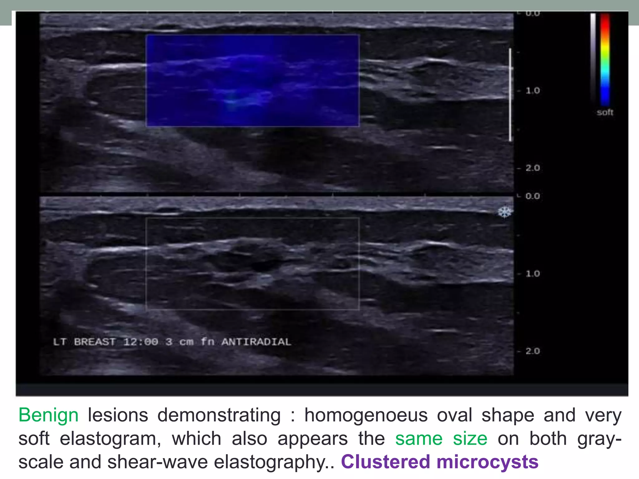 Elastography dr vineet | PPTX