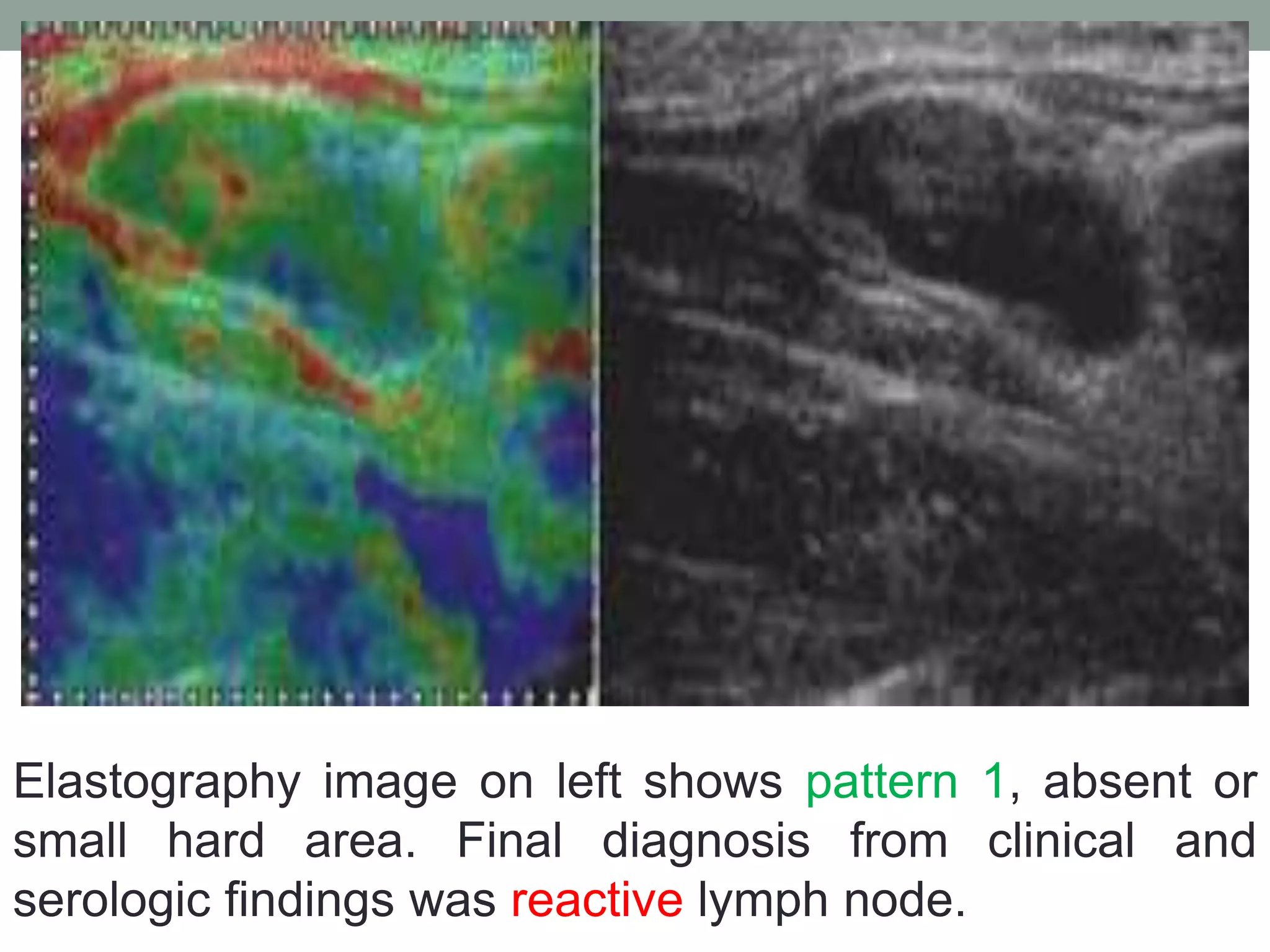 Elastography dr vineet | PPTX