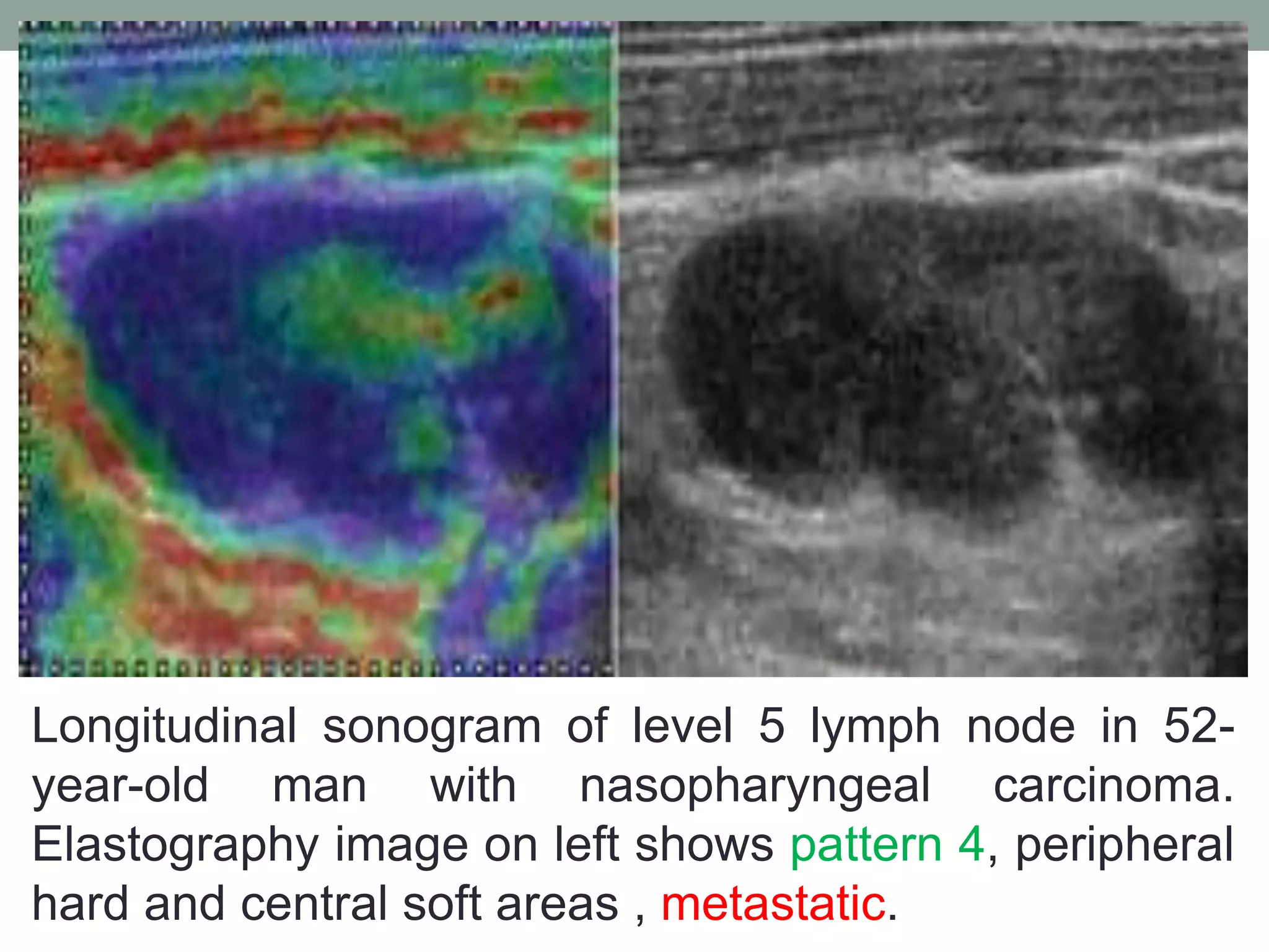 Elastography dr vineet | PPTX