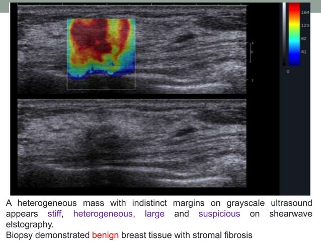 Elastography dr vineet | PPT