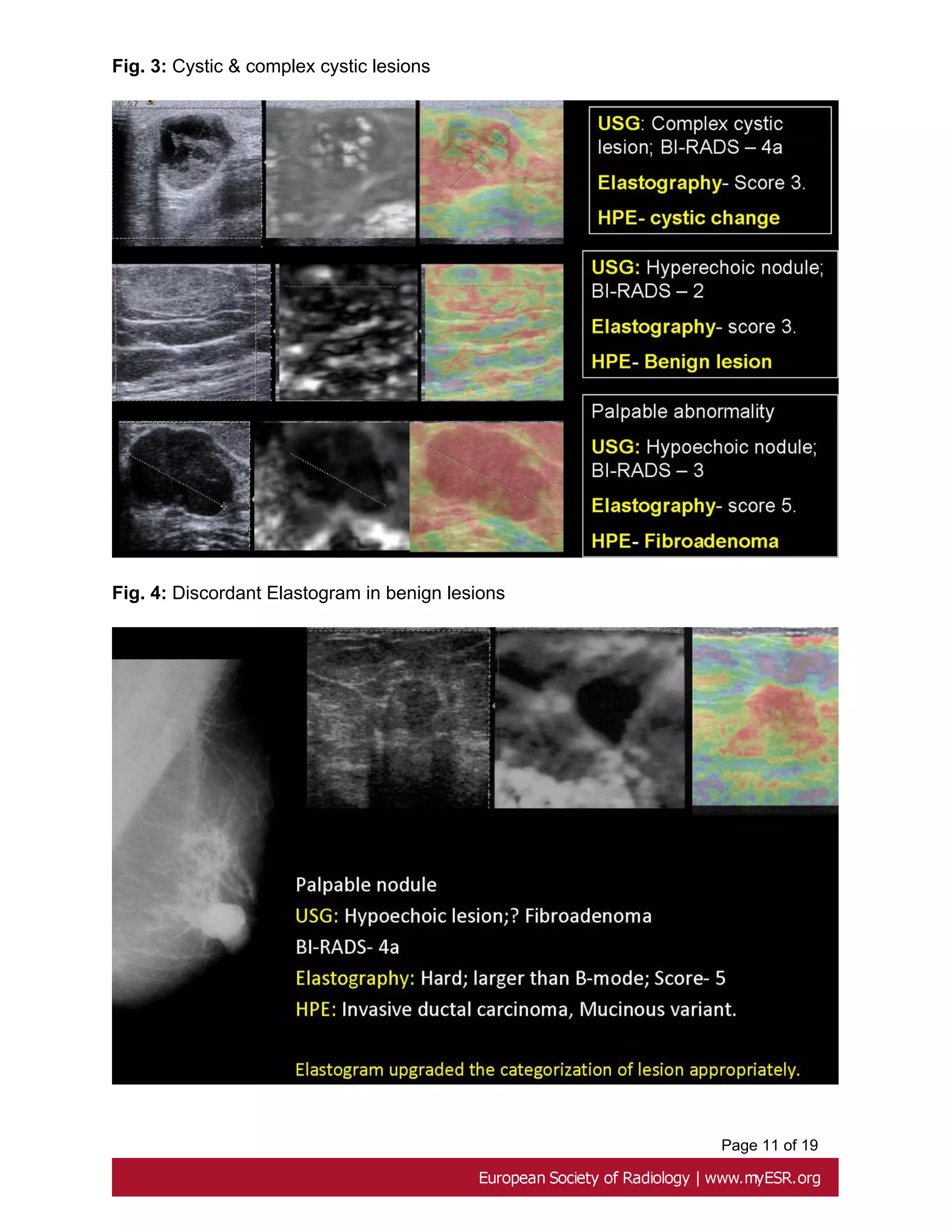 Elastography: An Additional Tool for Characterisation of Breast Lesions ...
