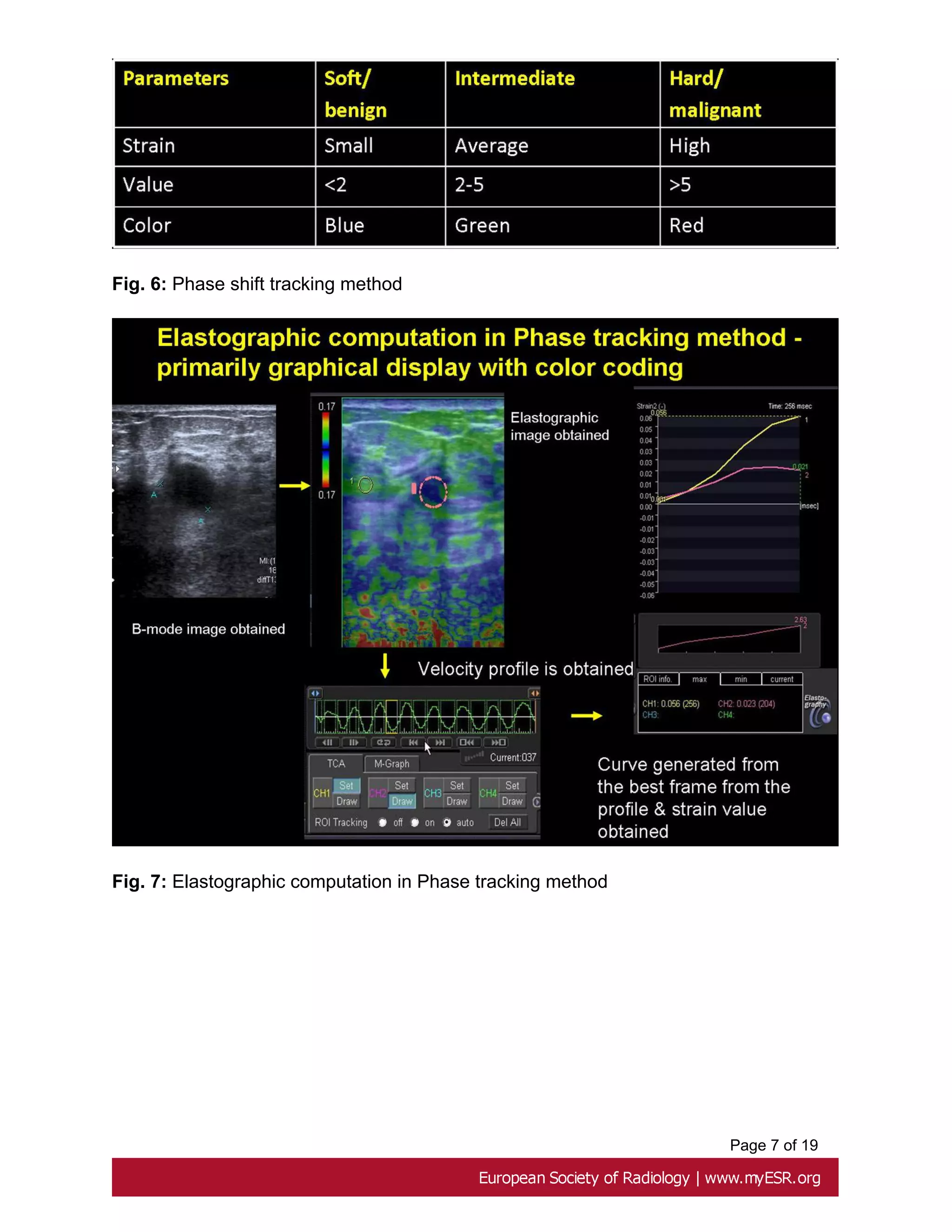 Elastography: An Additional Tool for Characterisation of Breast Lesions ...