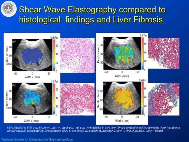 Elastography and ceus gilja | PPT